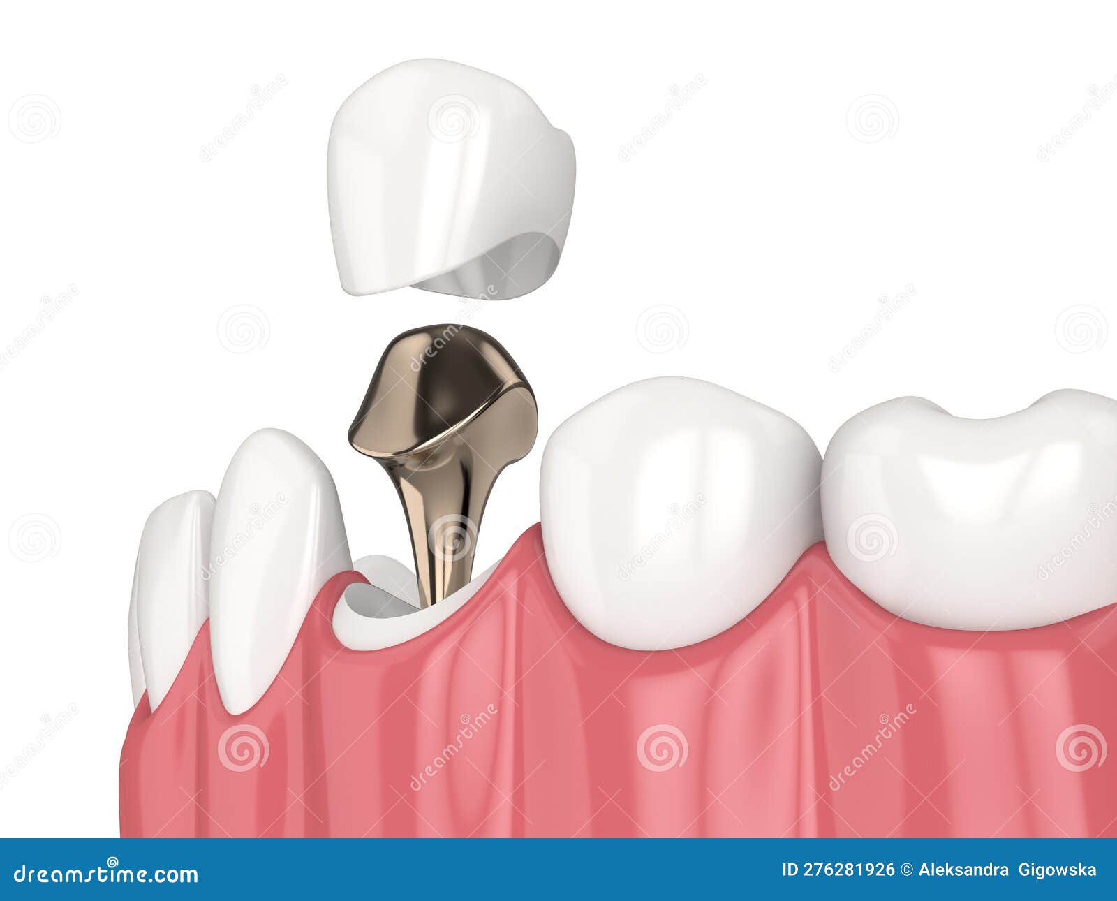 3d Render of Lower Jaw with Cast Post and Core Tooth Restoration Stock ...