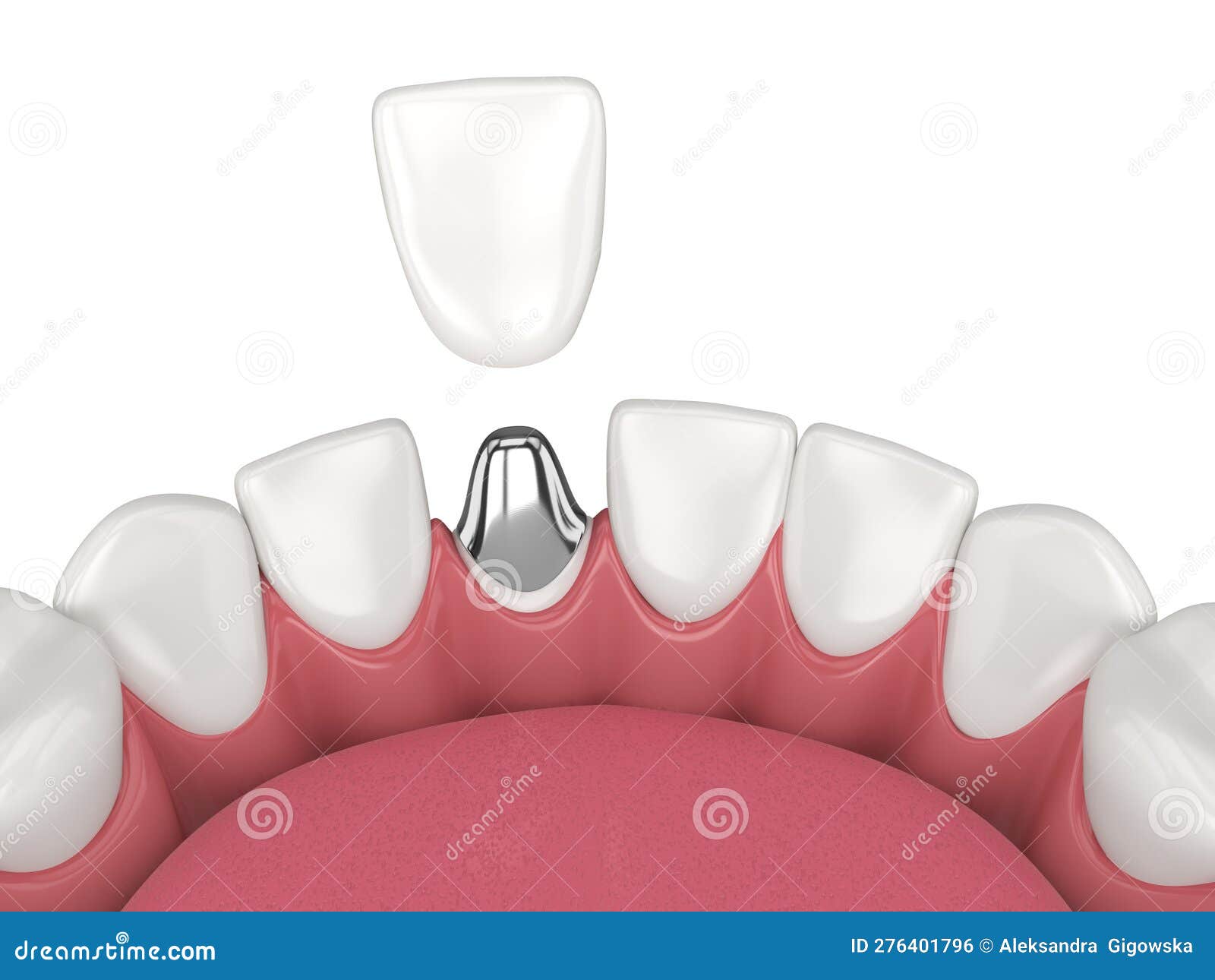 3d Render of Lower Jaw with Cast Post and Core Tooth Restoration Stock ...