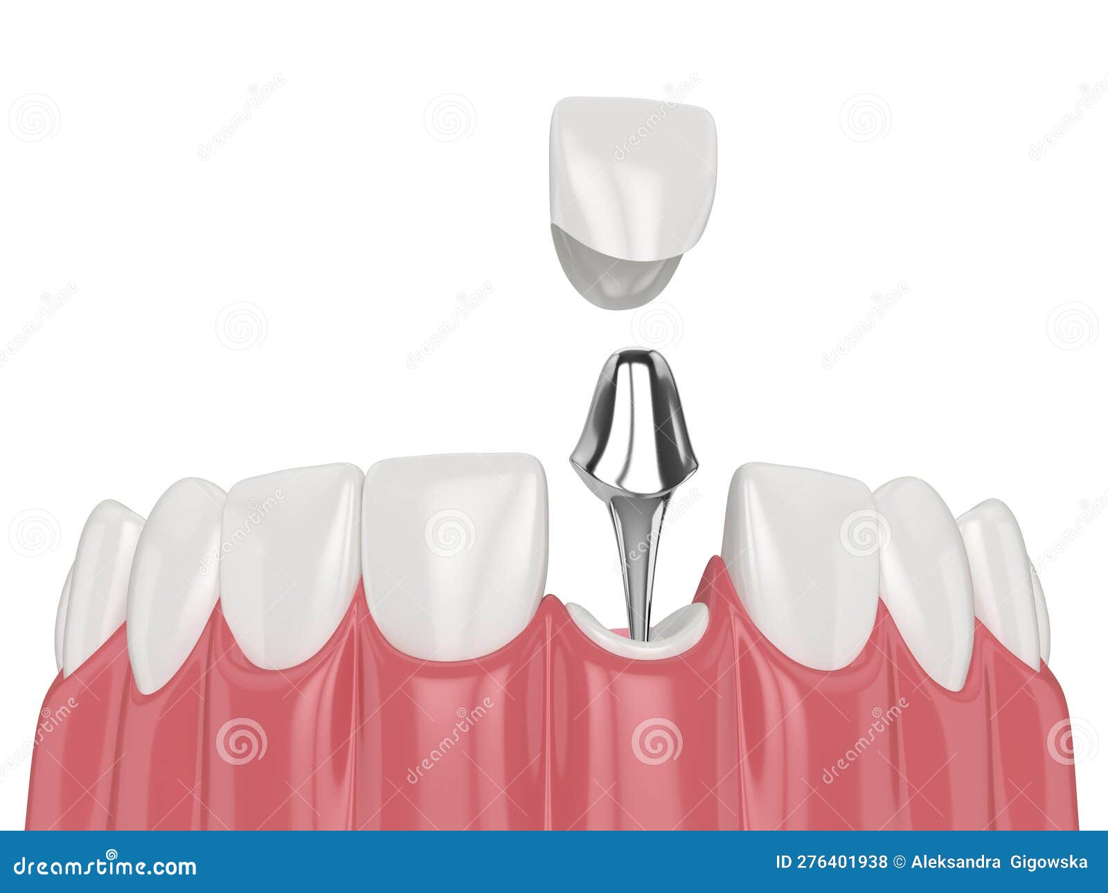3d Render of Lower Jaw with Cast Post and Core Tooth Restoration Stock ...