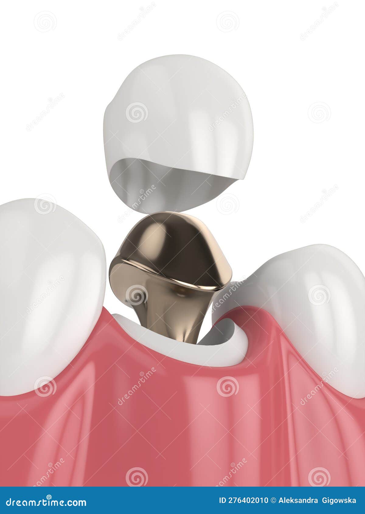 3d Render of Lower Jaw with Cast Post and Core Tooth Restoration Stock ...