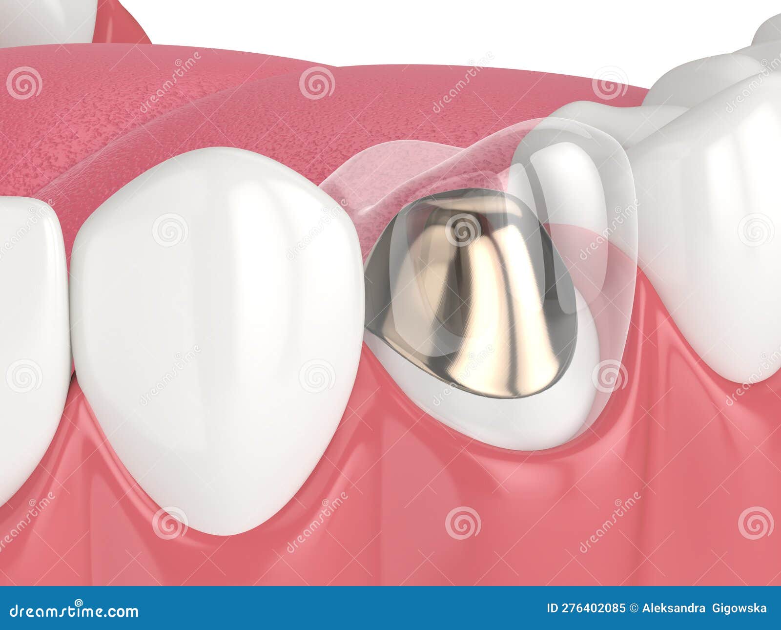 3d Render of Lower Jaw with Cast Post and Core Tooth Restoration Stock ...