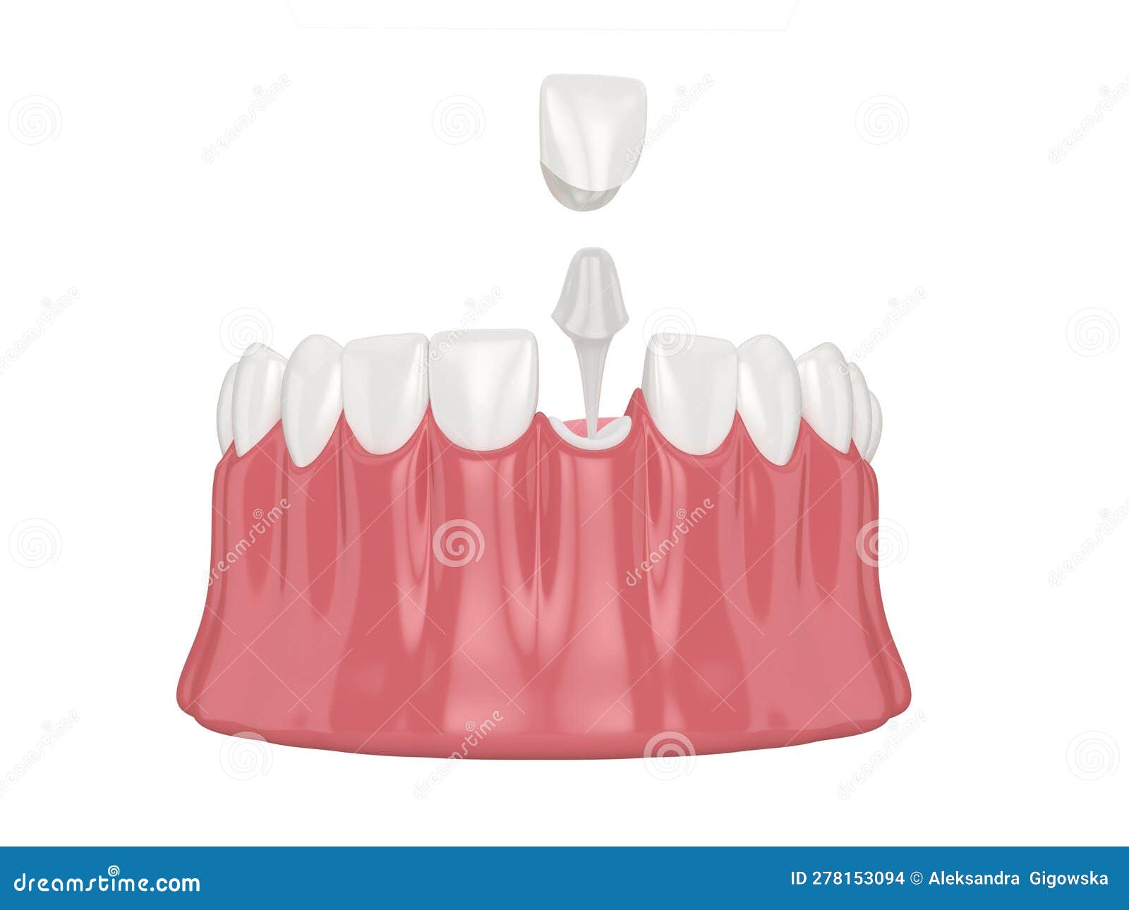 3d Render of Lower Jaw with Post and Core Tooth Restoration Stock ...