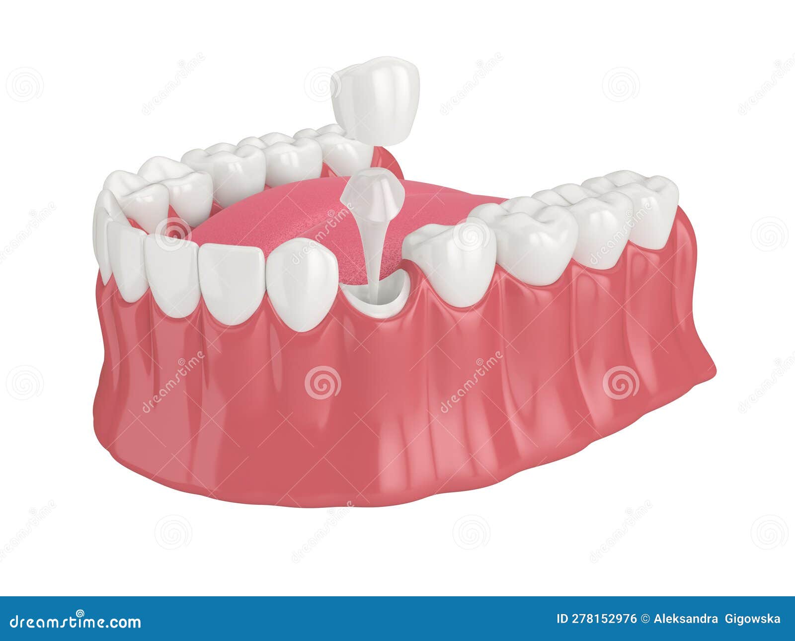 3d Render of Lower Jaw with Post and Core Tooth Restoration Stock ...