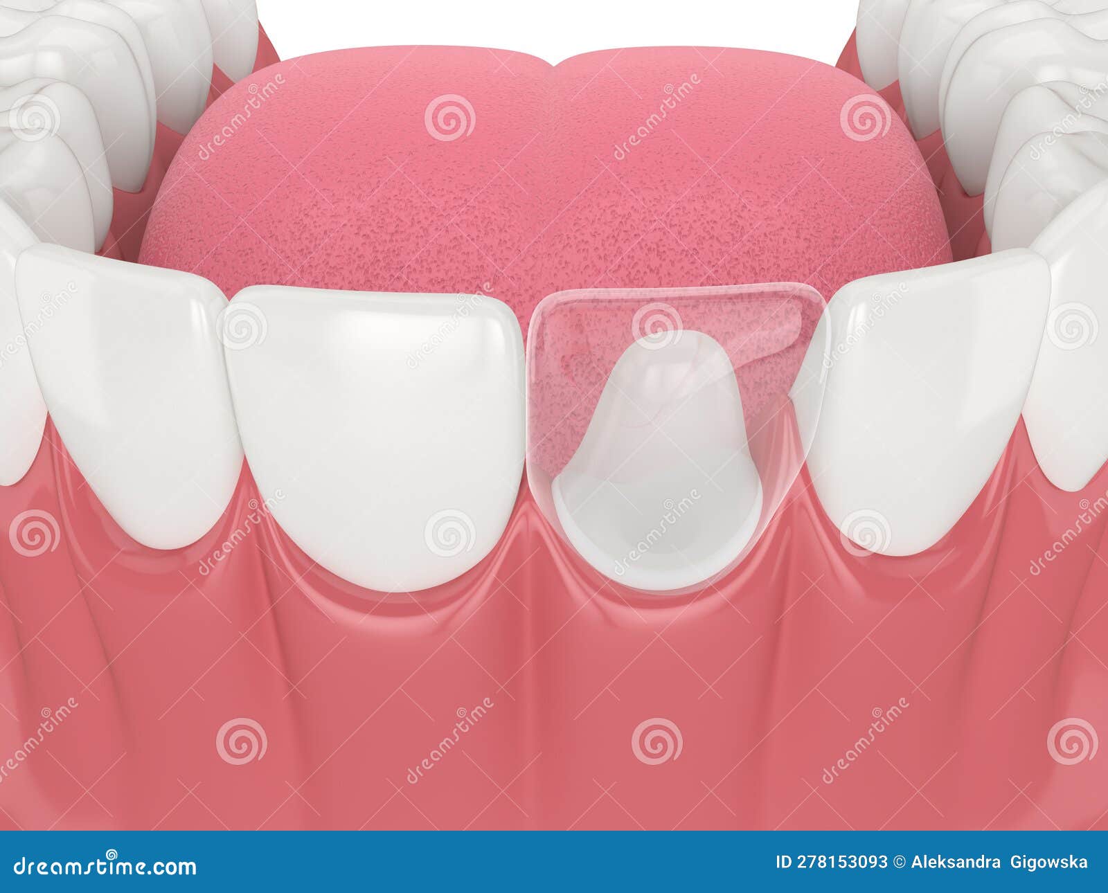 3d Render of Lower Jaw with Post and Core Tooth Restoration Stock ...