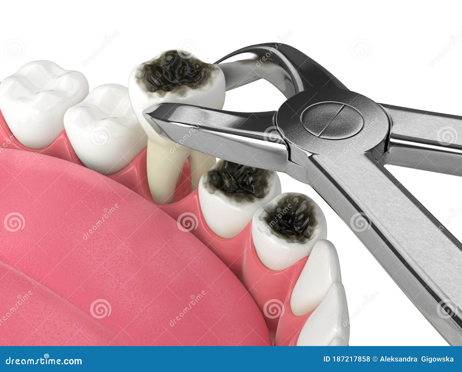 Extracted Caries Tooth On Isolated A White Background 3d Illustration ...