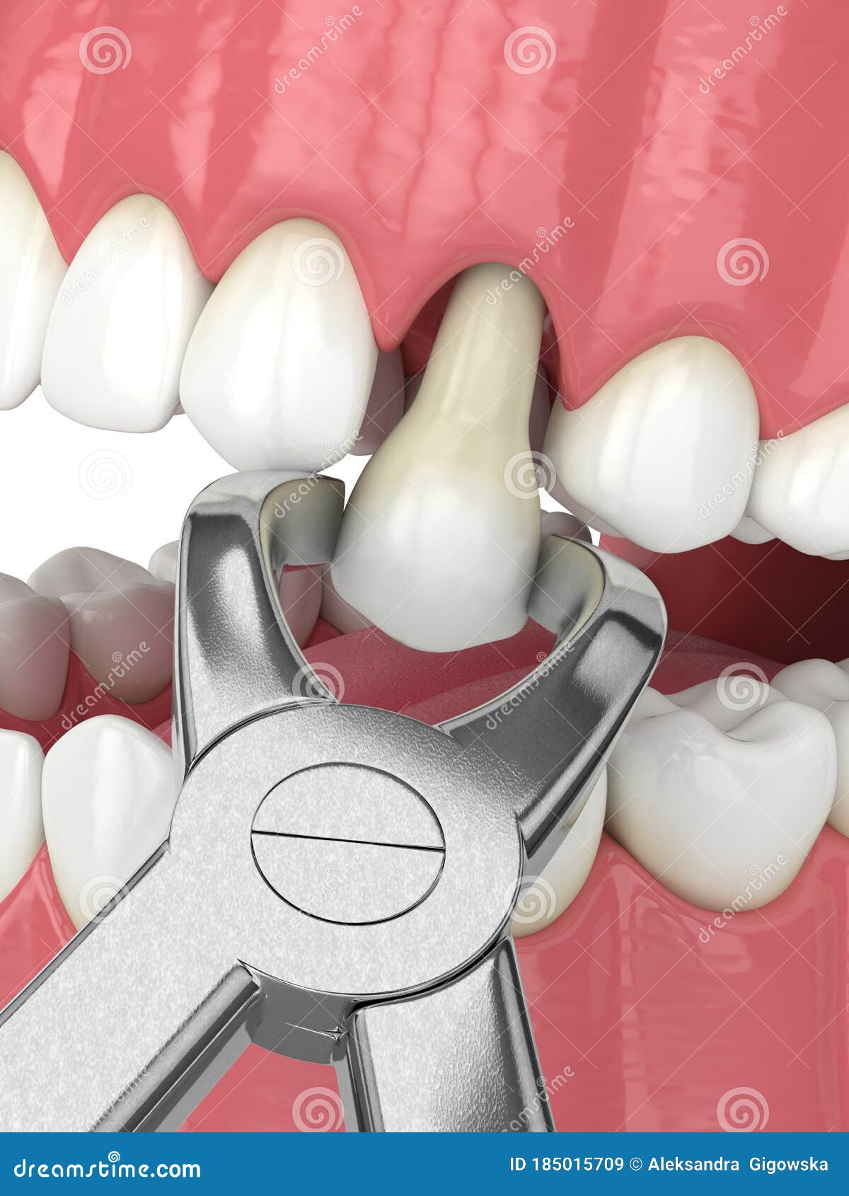 3d Render of Lower Jaw with Tooth Extraction Stock Illustration ...