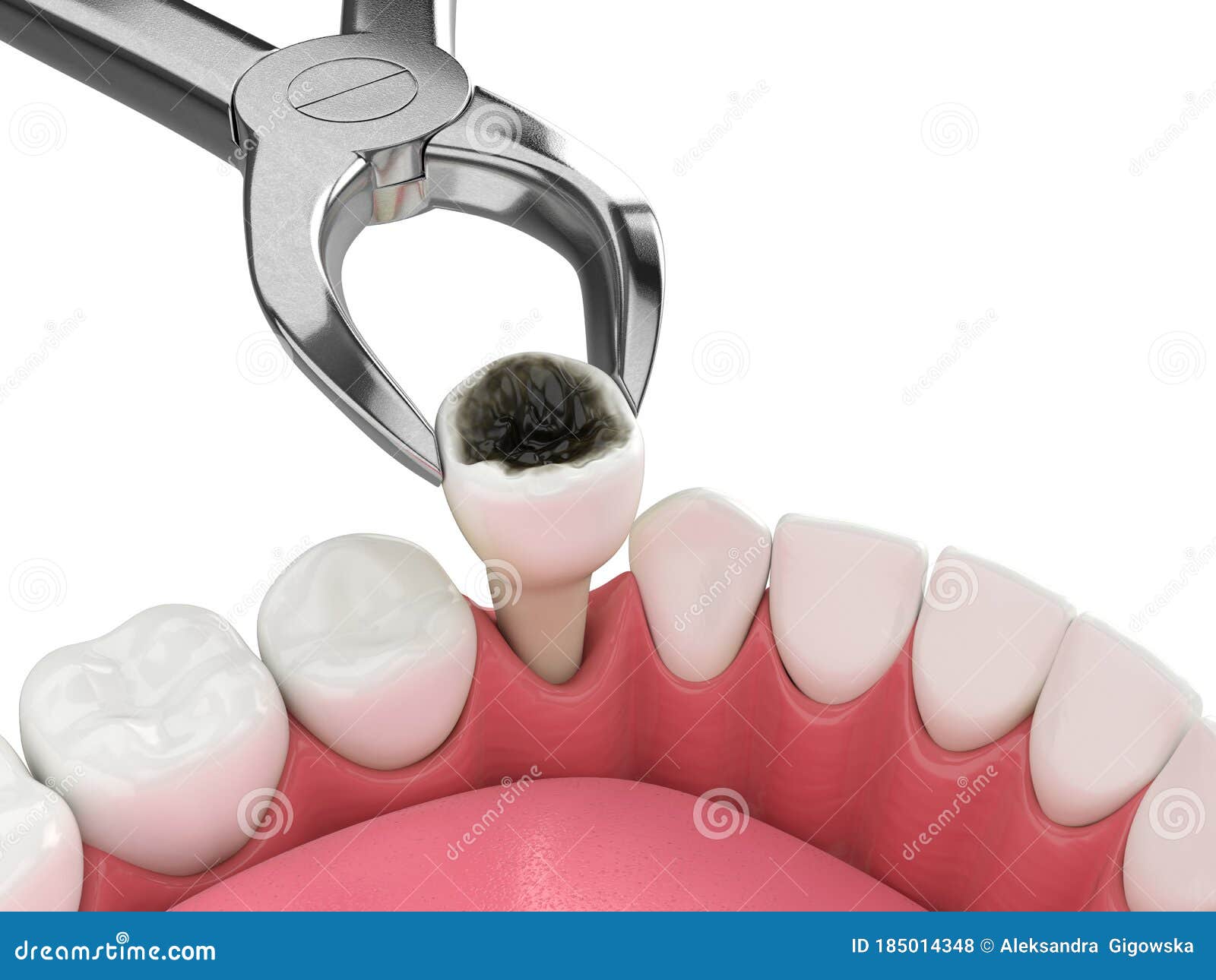 3d Render of Lower Jaw with Tooth Extraction Stock Illustration ...