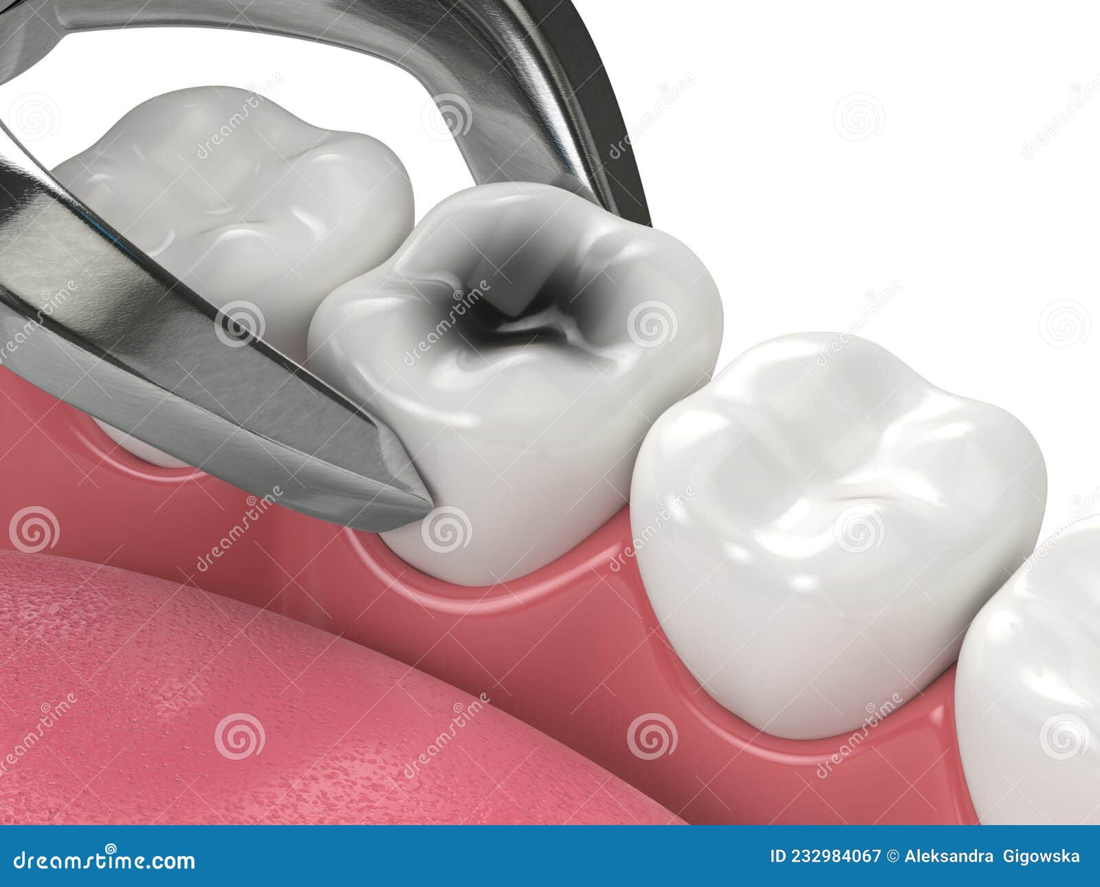 3d Render of Lower Jaw with Tooth Extraction Stock Illustration ...