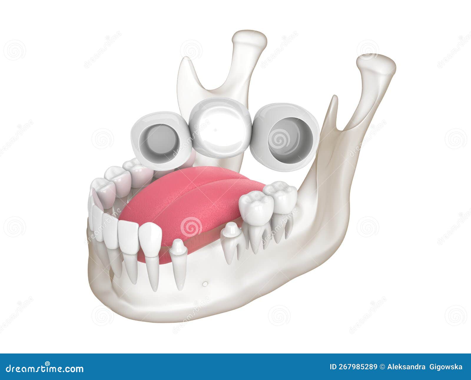 3d Render of Mandible with Dental Bridge Over Molar and Premolar Teeth ...
