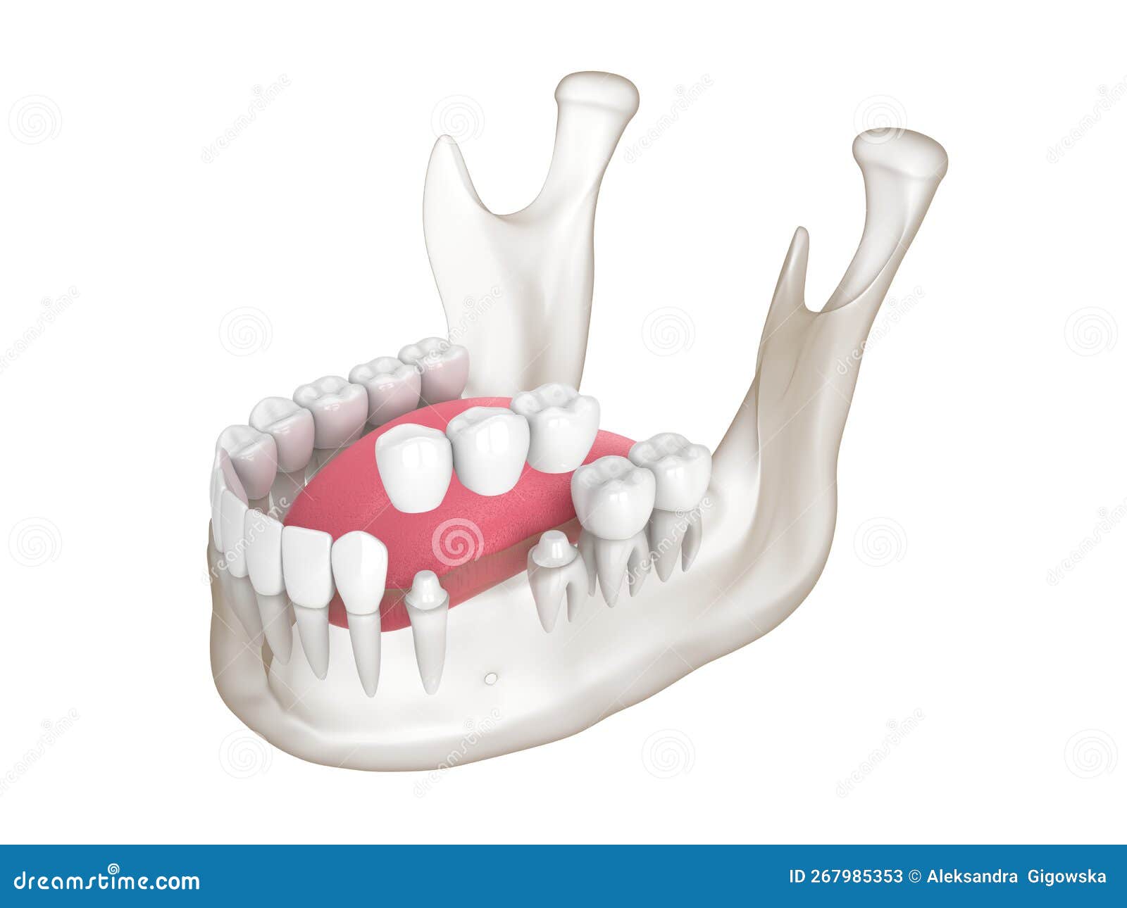 3d Render of Mandible with Dental Bridge Over Molar and Premolar Teeth ...