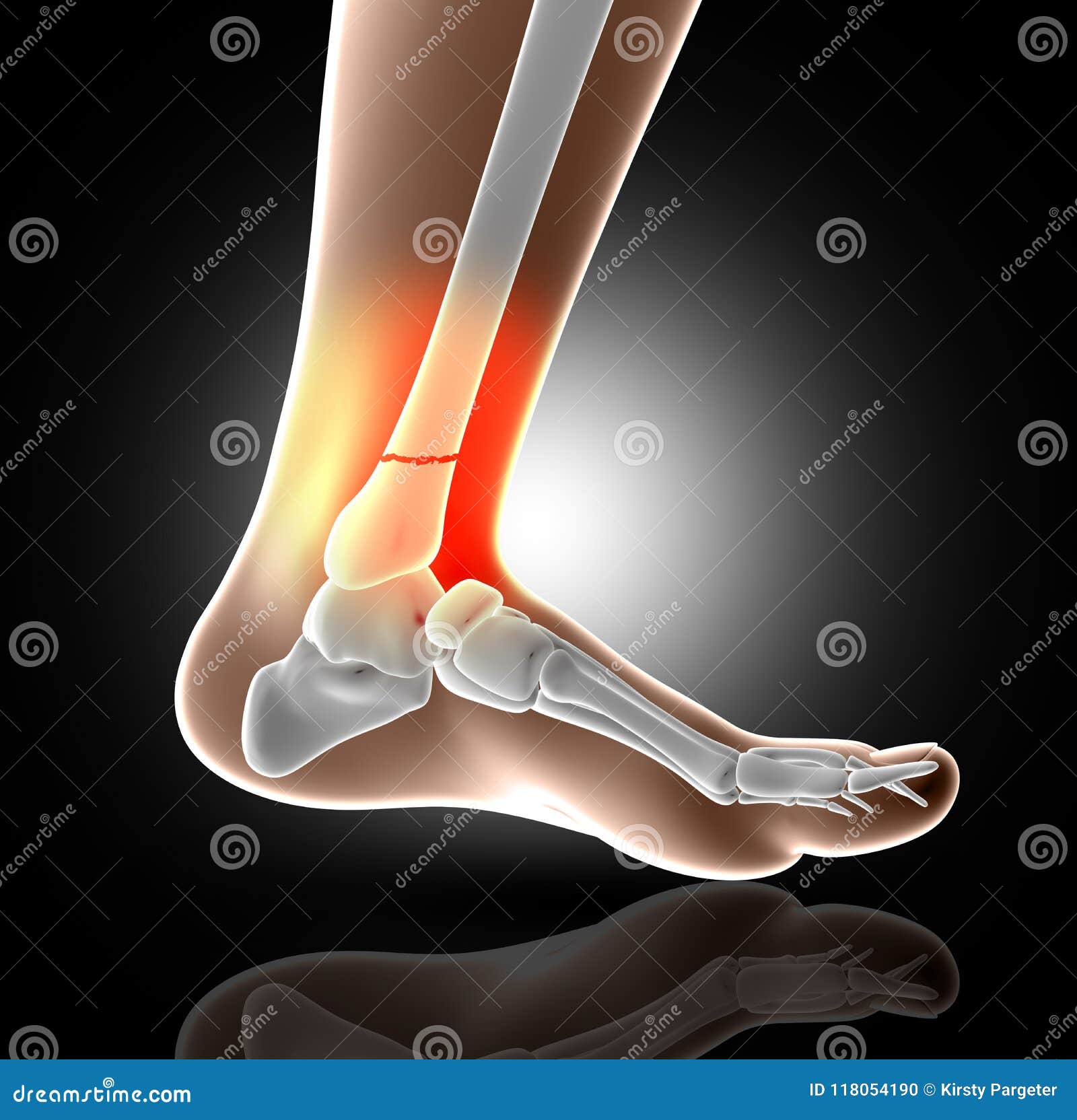 3D Medical Image Showing Broken Leg Bone Stock Illustration ...