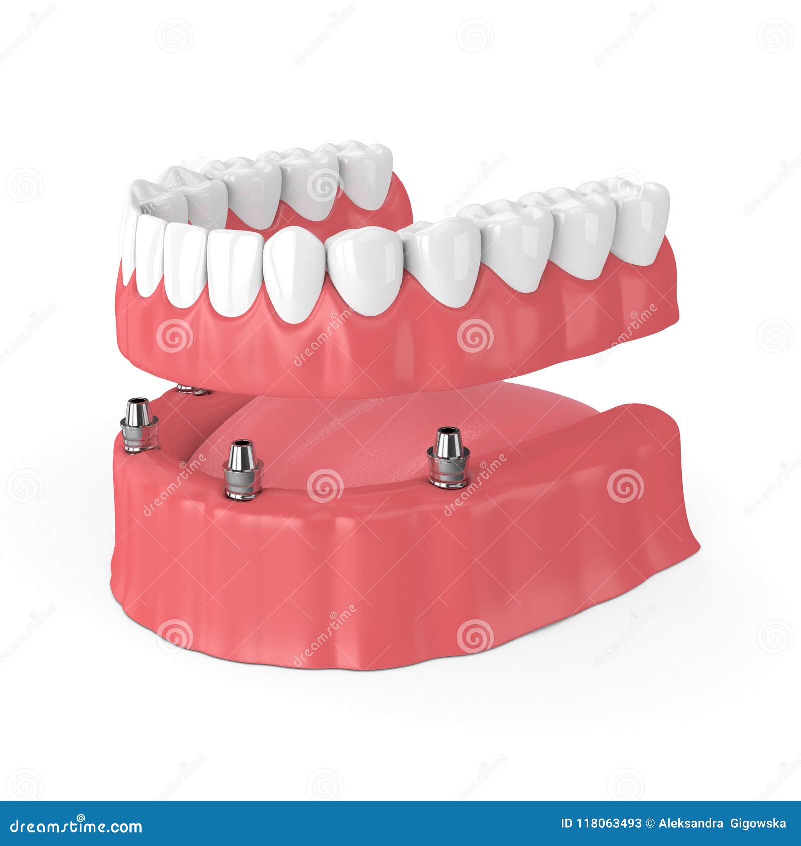 3d Render of Removable Full Implant Denture Stock Illustration ...