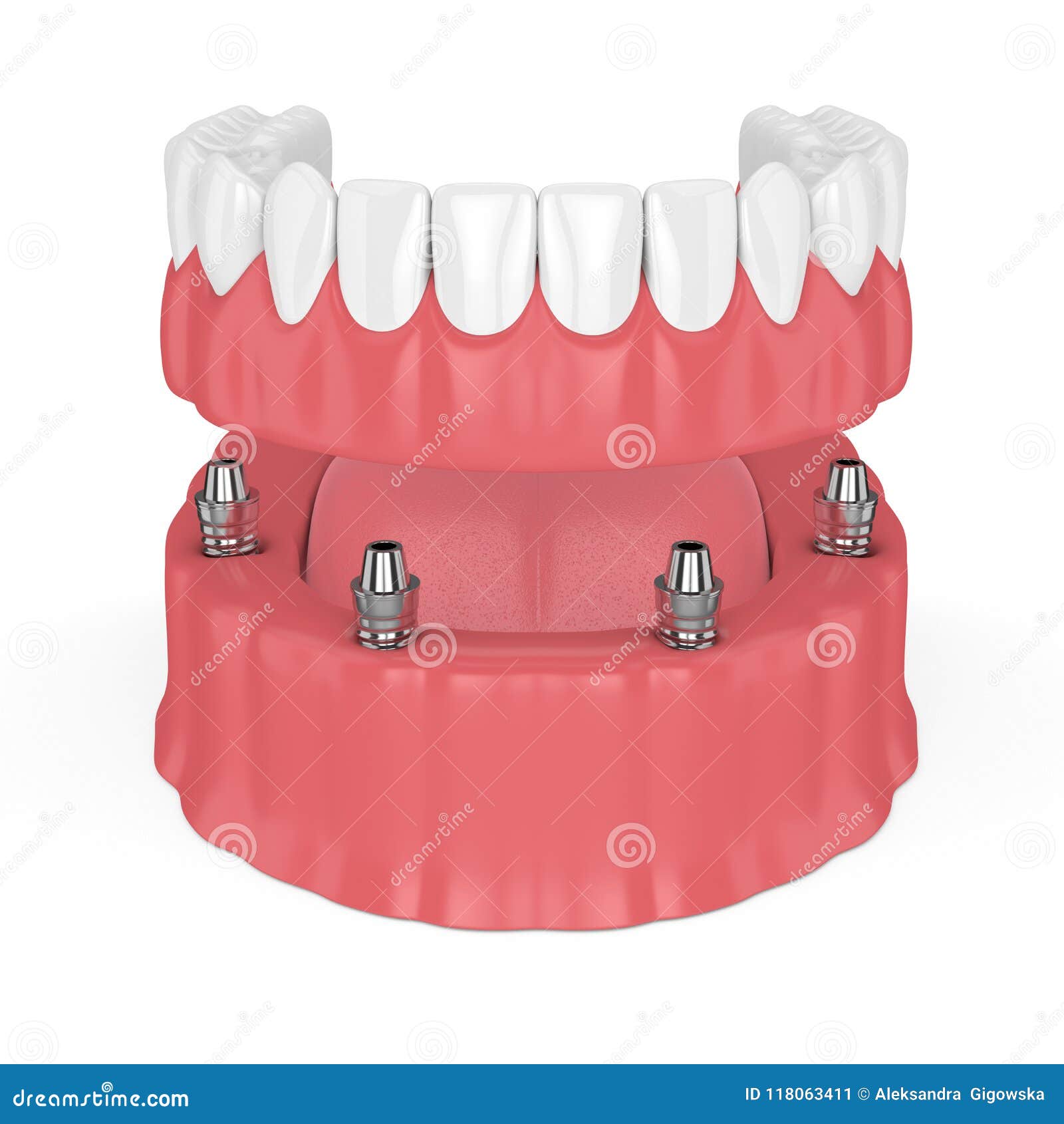 3d Render Of Jaw With Implant Screw And Healing Cap Royalty-Free Stock ...