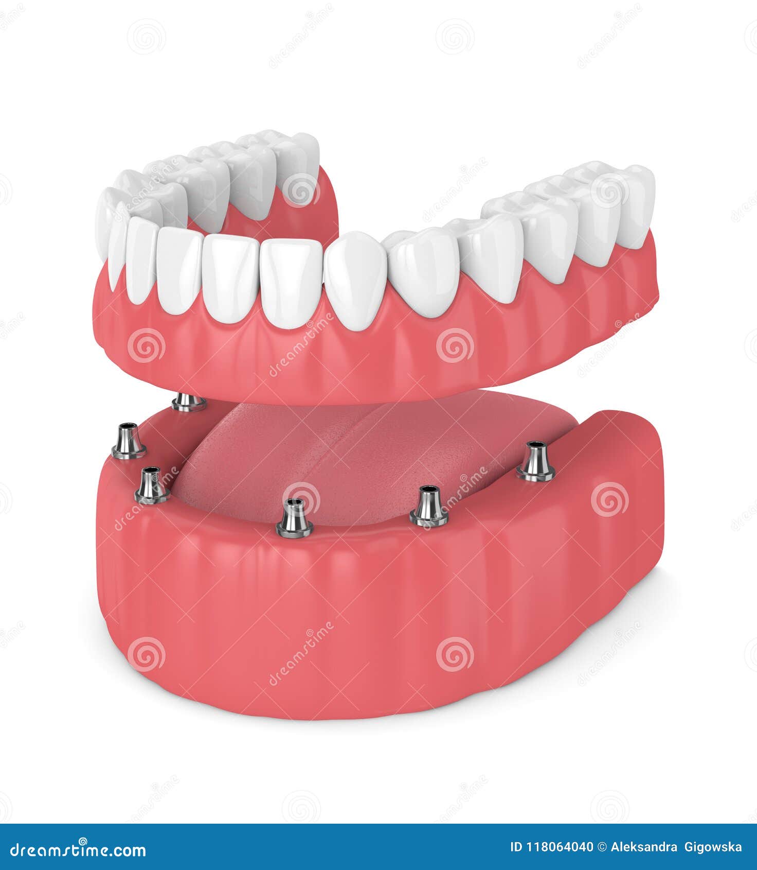 3d Render Of Jaw With Implant Screw And Healing Cap Royalty-Free Stock ...