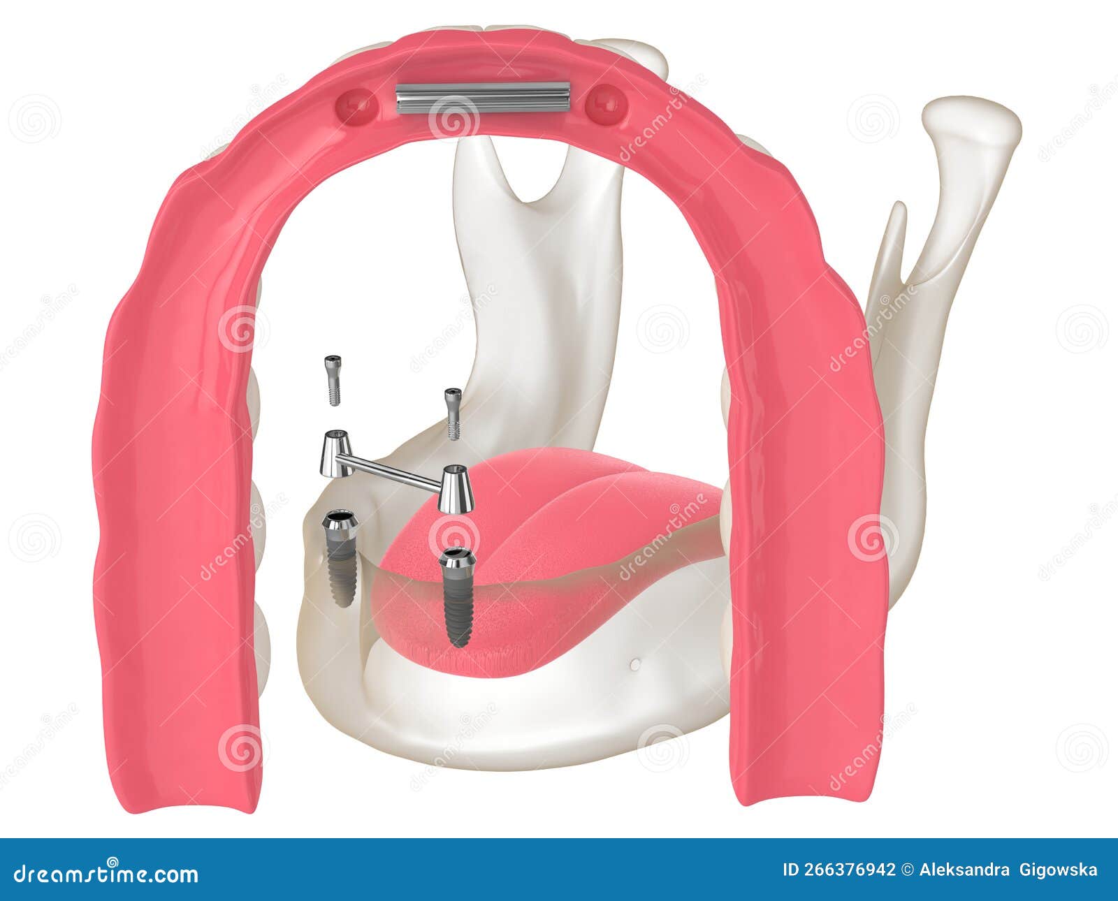 3d Render of Removable Overdenture Installation on Bar Clip Attachment ...