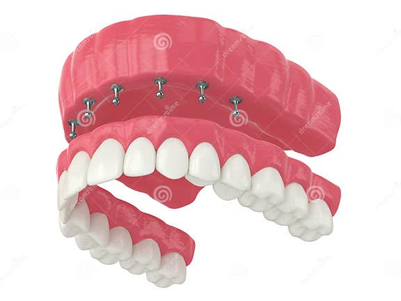 3d Render of Removable Snap-on Full Implant Denture Installation Stock ...
