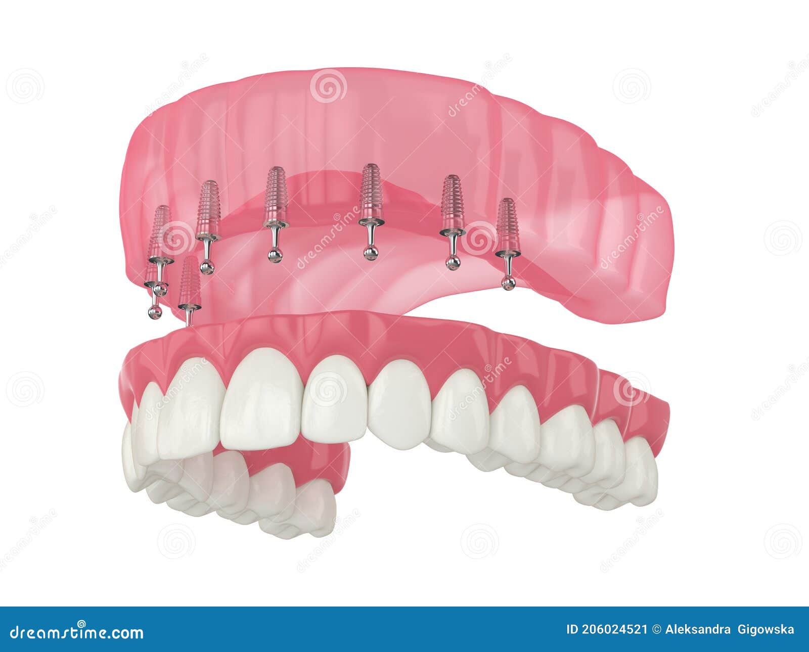 3d Render of Removable Snap-on Full Implant Denture Installation Stock ...