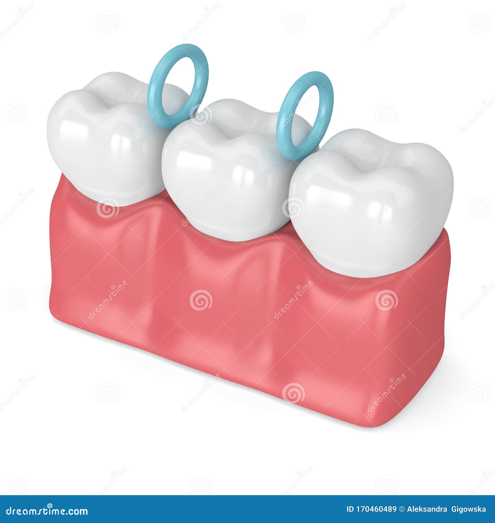 3d Render of Rubber Separators between Teeth Stock Illustration ...