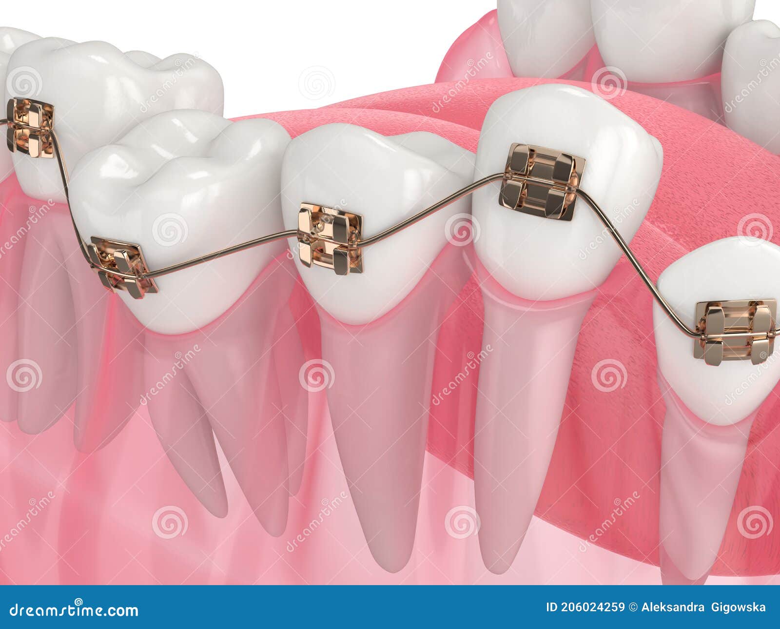 3d Render of Teeth Alignment by Orthodontic Braces Stock Illustration ...