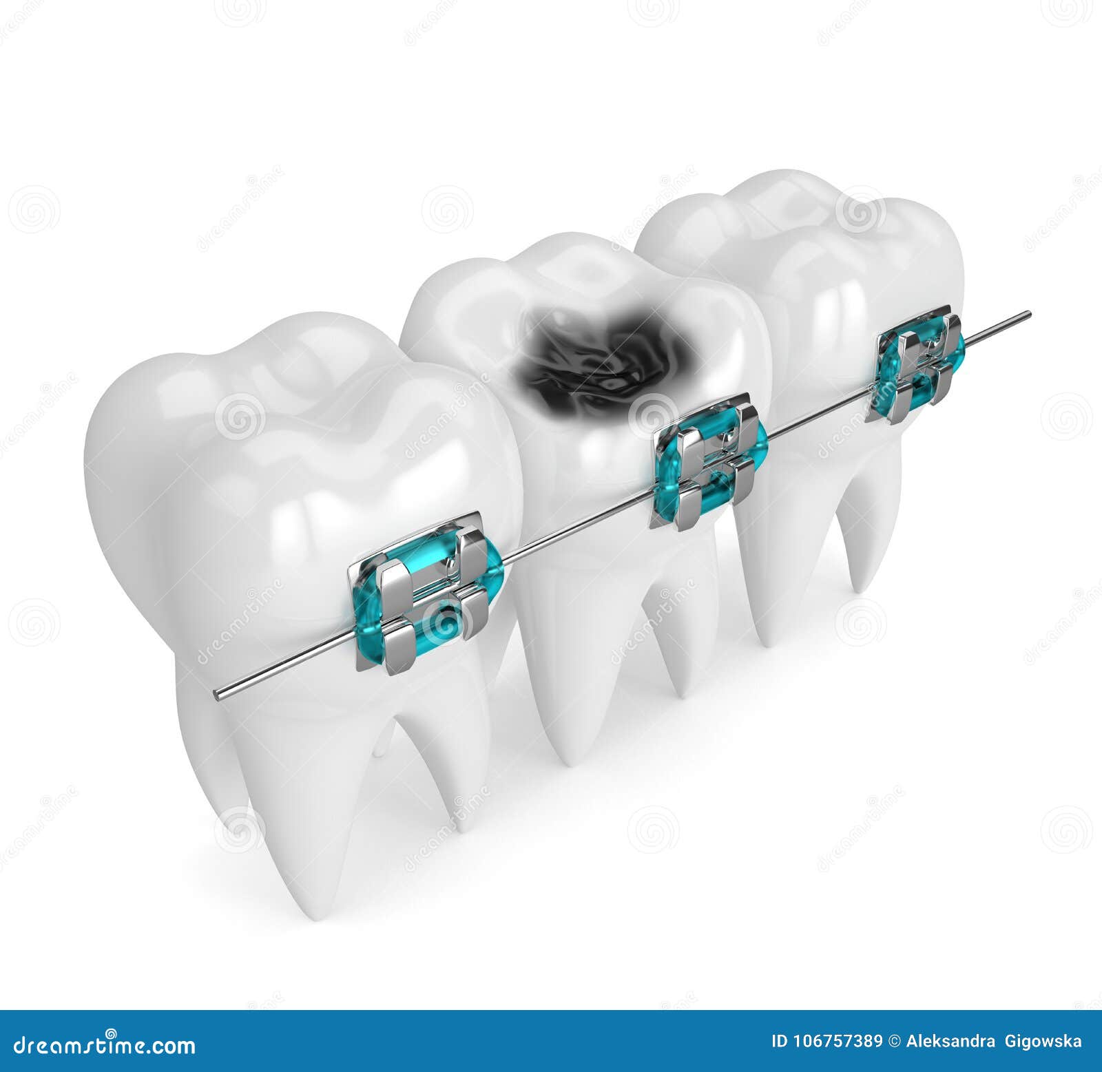 3d Render of Teeth with Braces and Caries Stock Illustration ...
