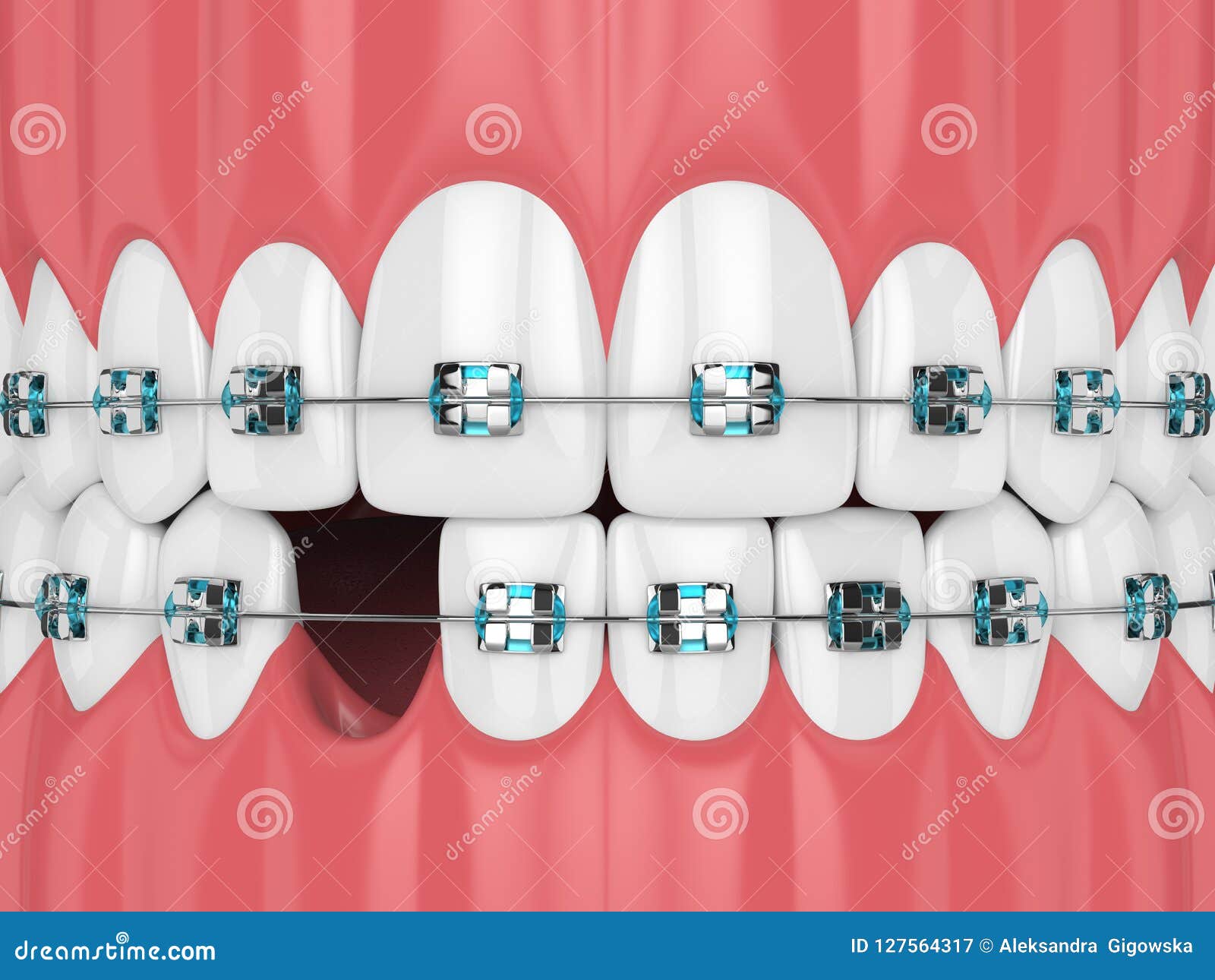 3d Render of Teeth with Braces and Cavity Stock Illustration ...