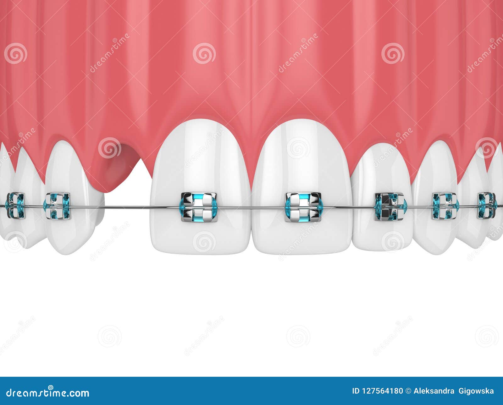 3d Render of Teeth with Braces and Cavity Stock Illustration ...