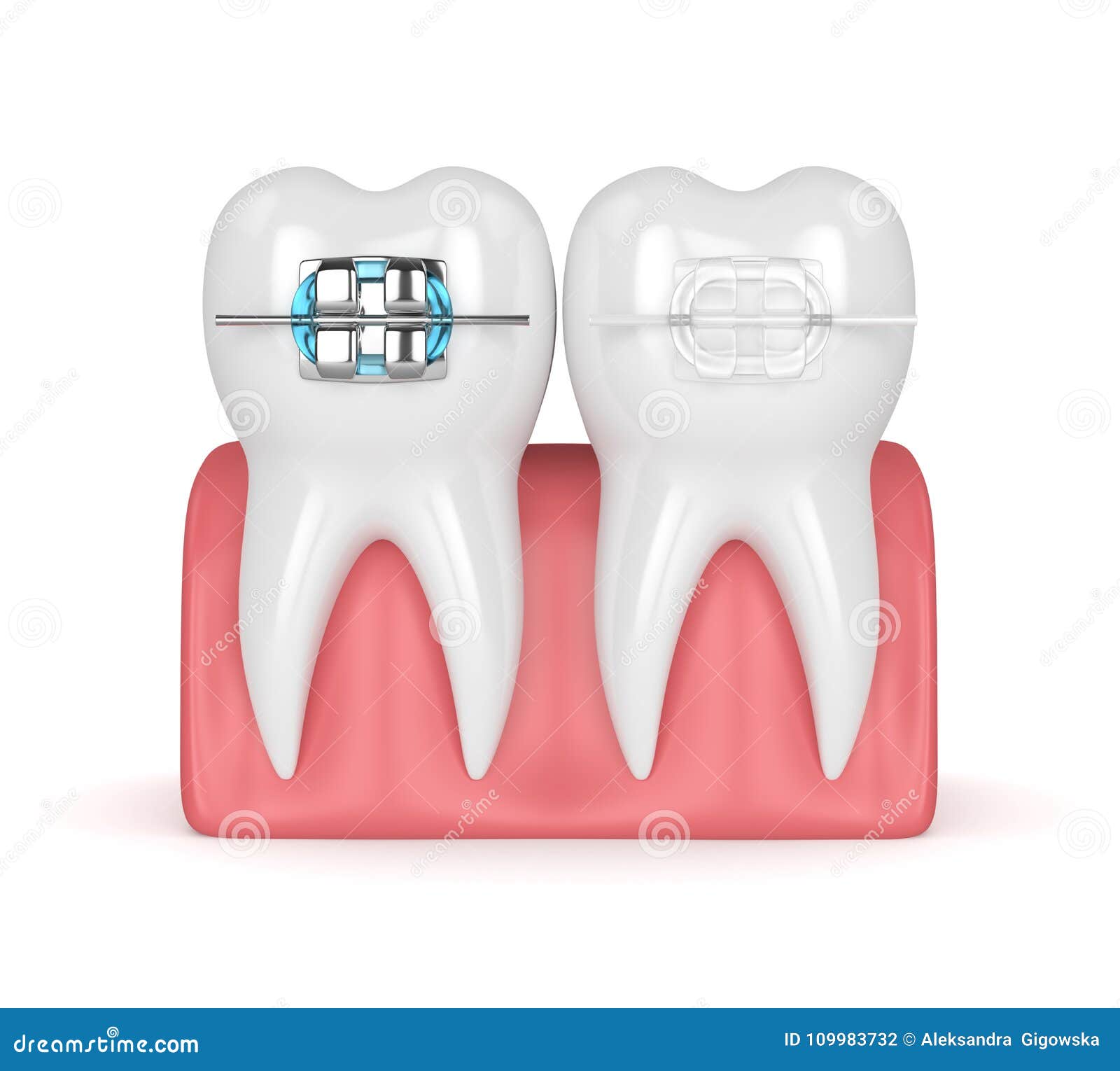 Metal Braces Vector. Human Jaw. Braces On Teeth. Smile With Braces. 3D ...