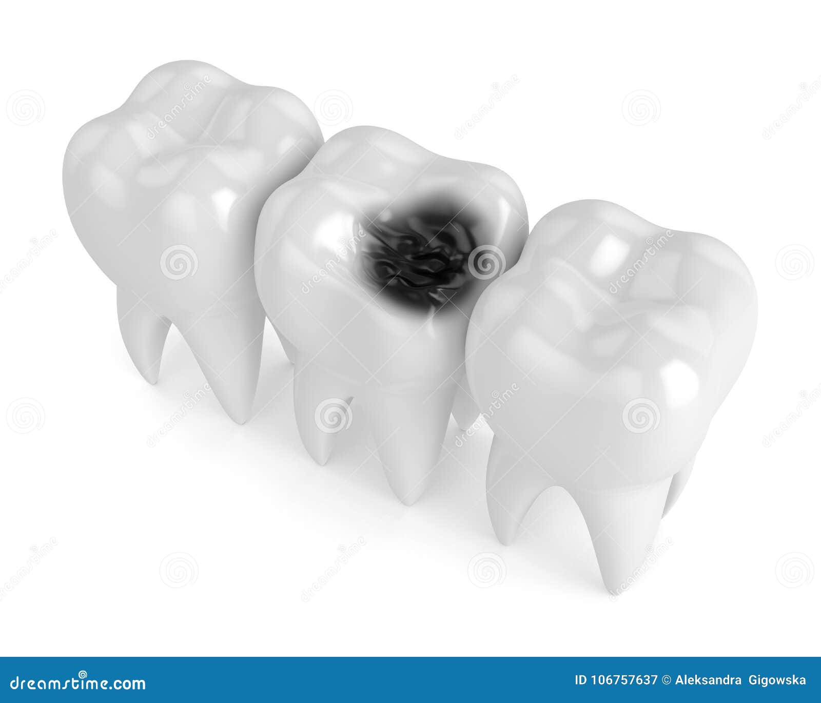 3d Render of Teeth with Decay Stock Illustration - Illustration of ...