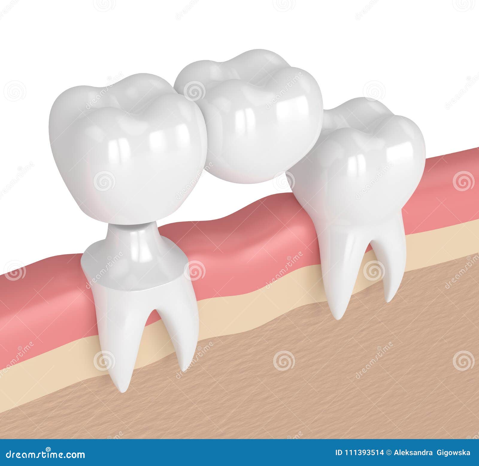 3d Render Of Teeth With Dental Cantilever Bridge Royalty-Free Stock ...
