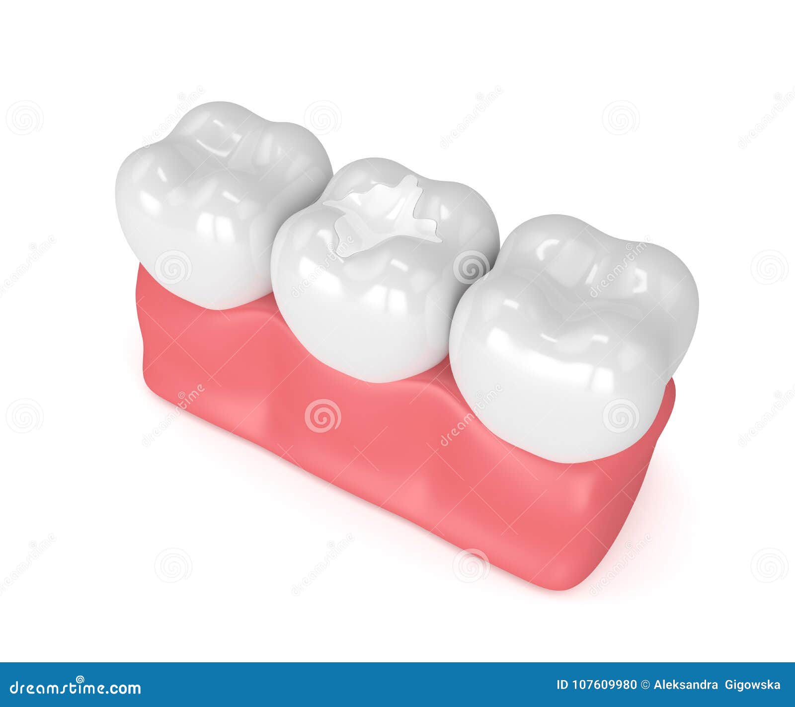 3d Render of Teeth with Dental Composite Filling Stock Illustration ...