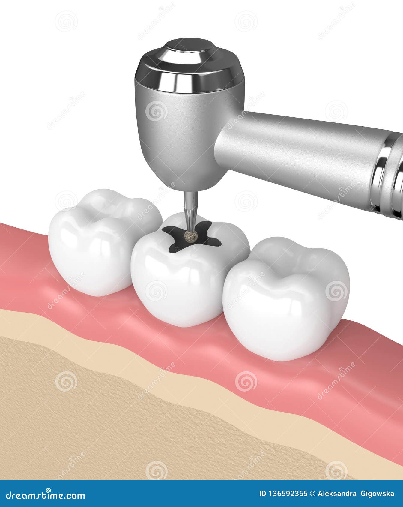 3d Render of Teeth with Dental Drill Stock Illustration - Illustration ...