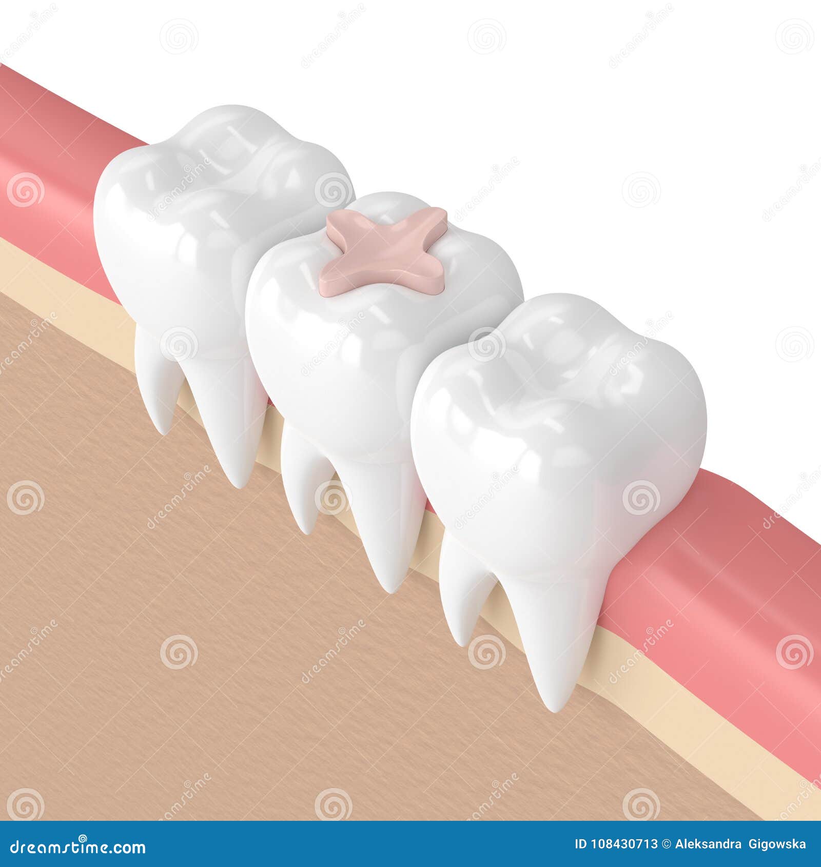3d Render of Teeth with Dental Inlay Filling Stock Illustration ...