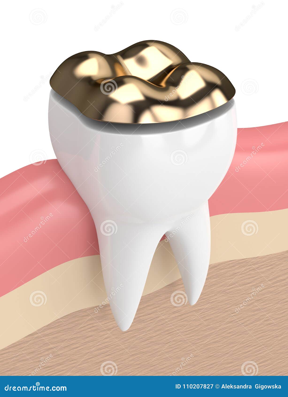 3d Render of Teeth with Dental Onlay Filling Stock Illustration ...
