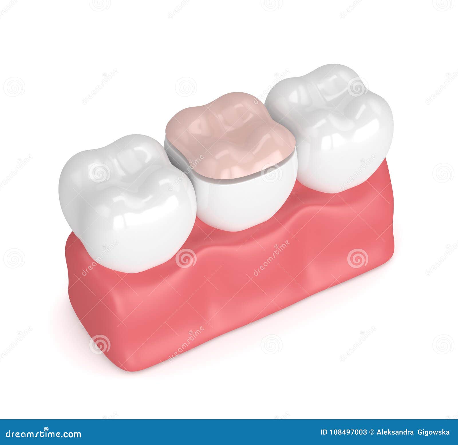 3d Render of Teeth with Dental Onlay Filling Stock Illustration ...