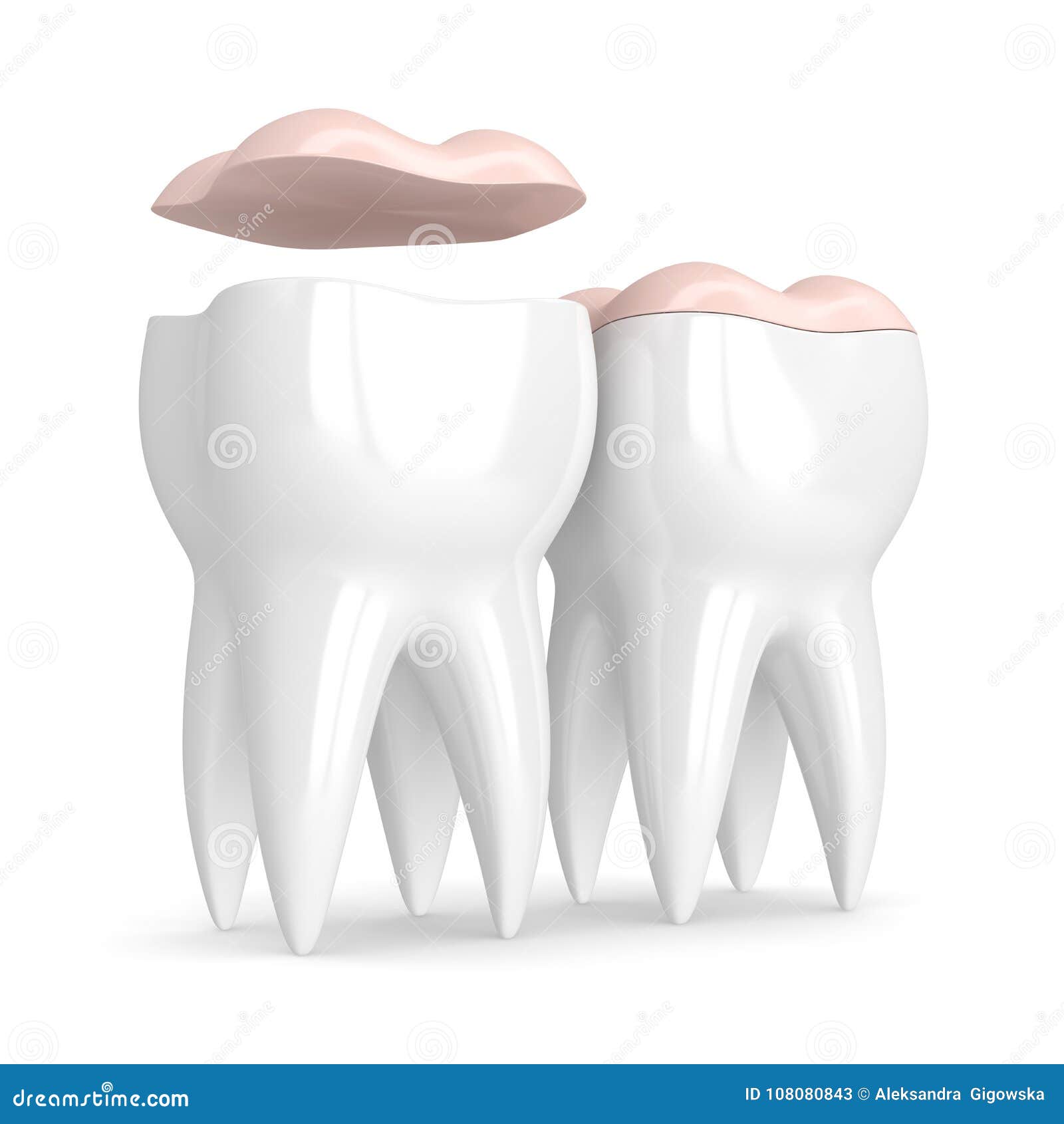 3d Render Of Teeth With Wisdom Vertical Impaction Royalty-Free Stock ...