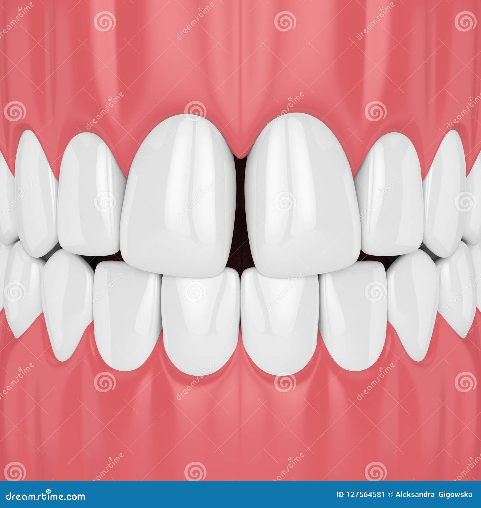 3d Render Of Diastema Closure Using Bonding Procedure Stock Photo ...