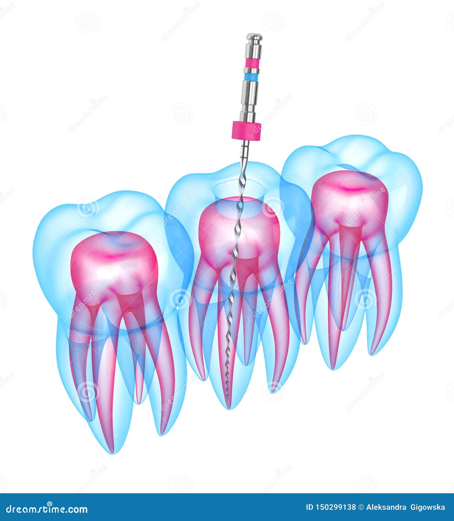 3d Render of Teeth with Endodontic File Over White Background Stock ...