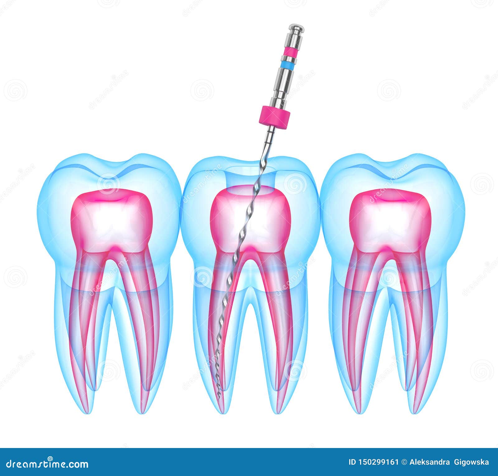 3d Render of Teeth with Endodontic File Over White Background Stock ...