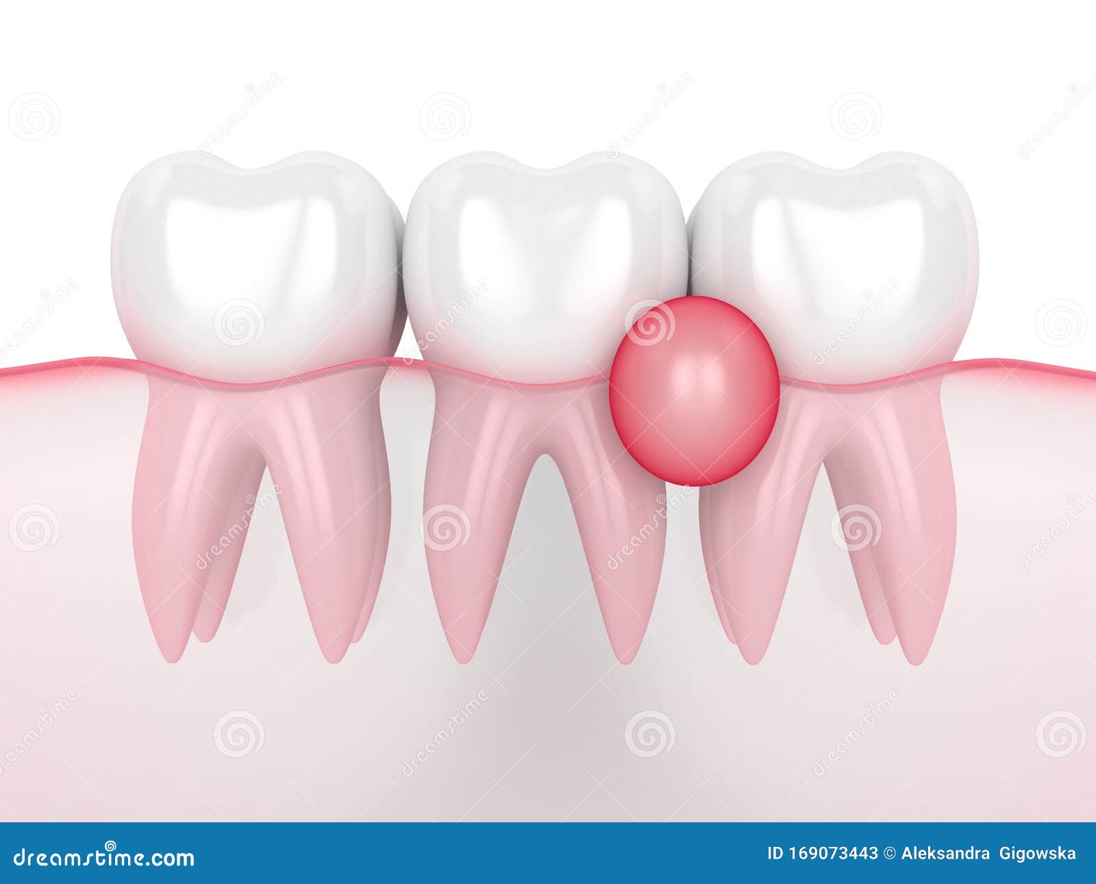 Dental Cyst Line Outline Icon Vector Illustration | CartoonDealer.com ...