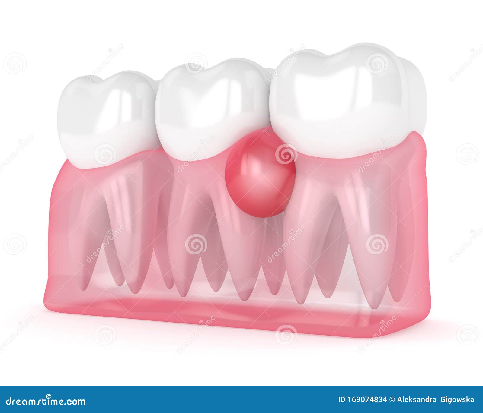 3d Render of Teeth in Gums with Cyst Stock Illustration - Illustration ...
