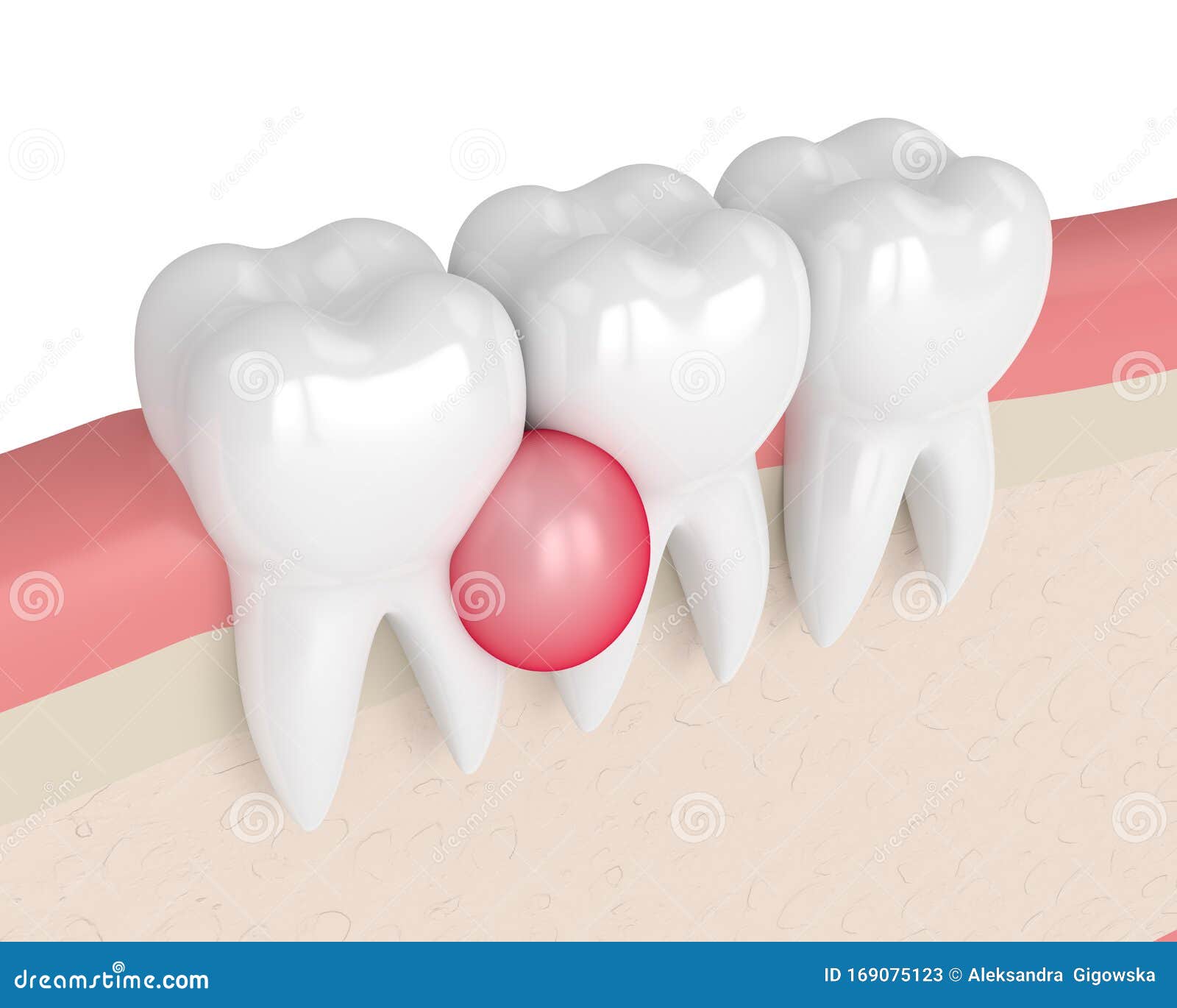 3d Render of Teeth in Gums with Cyst Stock Illustration - Illustration ...