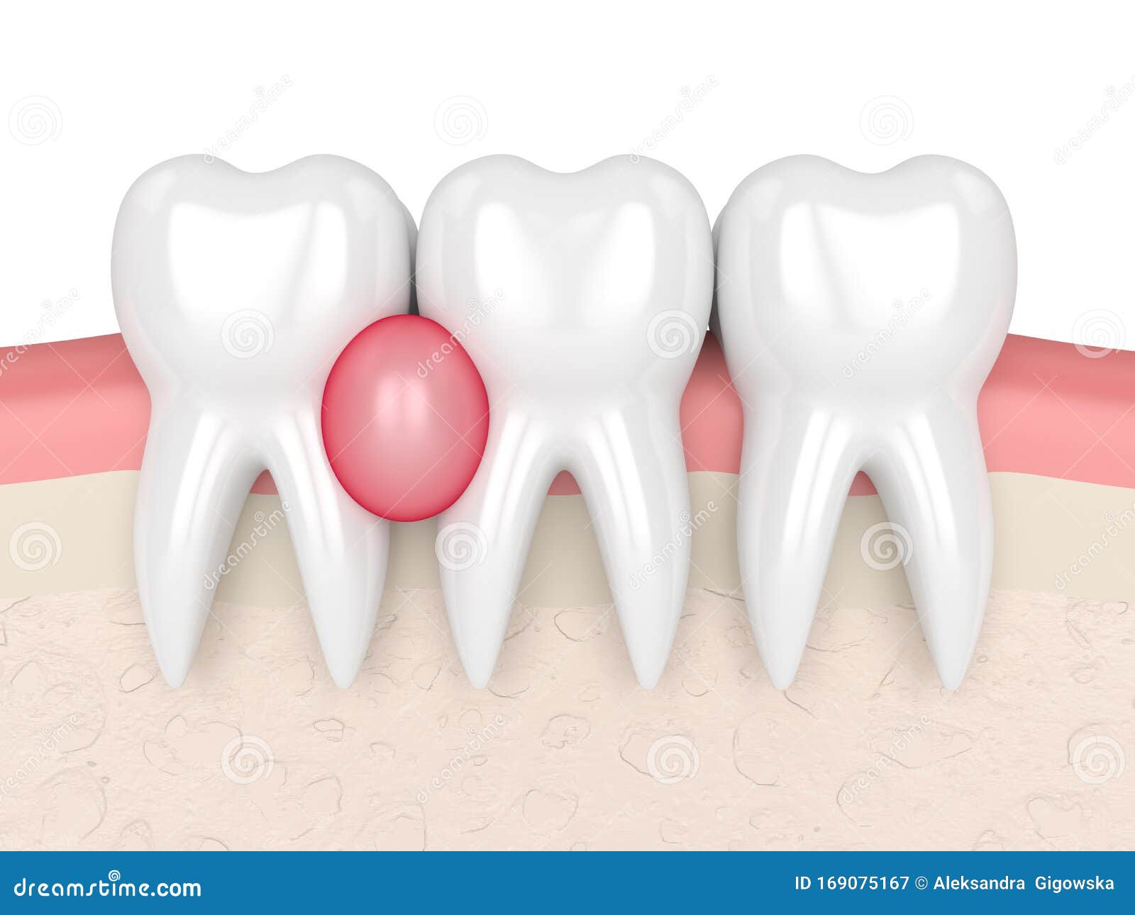 3d Render Of Jaw With Cyst On Teeth Root Stock Photo | CartoonDealer ...