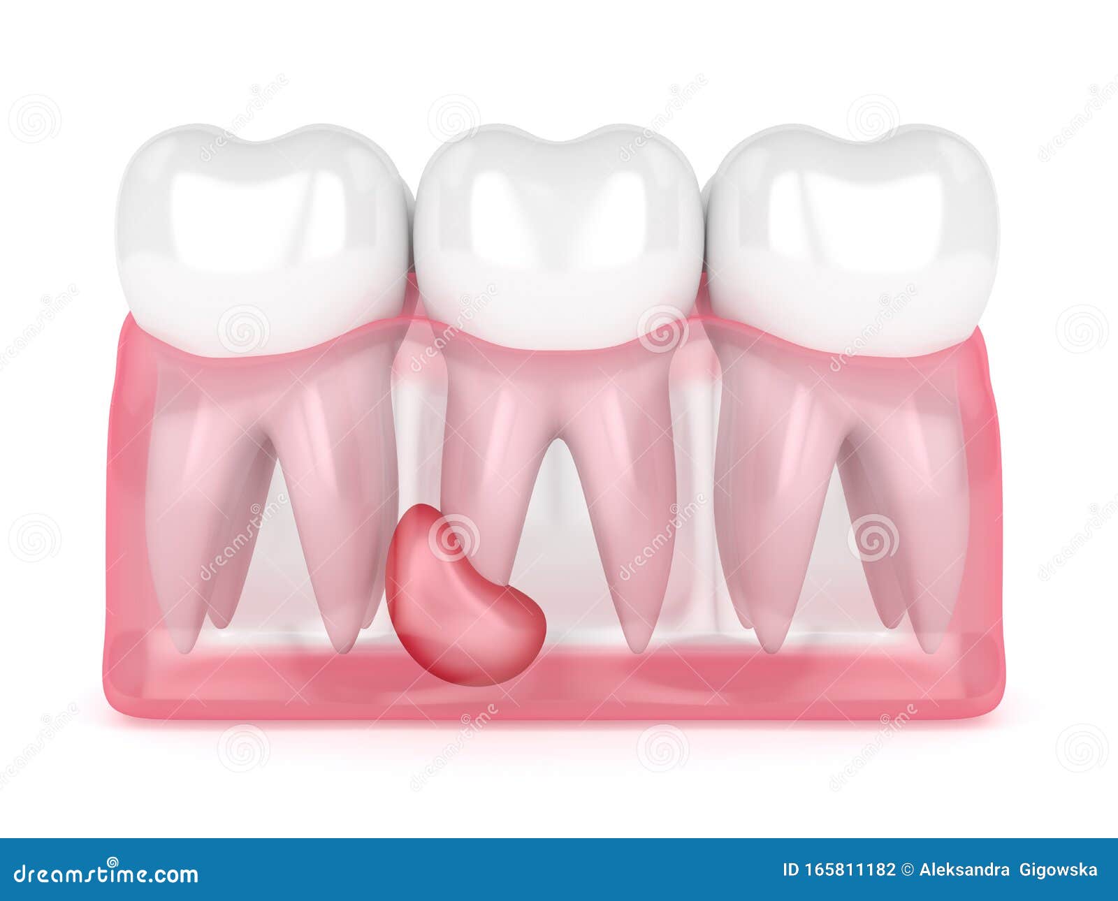 3d Render of Teeth in Gums with Cyst Stock Illustration - Illustration ...