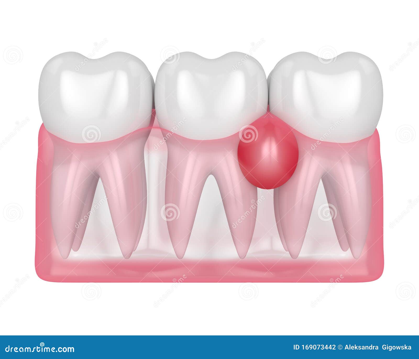 3d Render of Teeth in Gums with Cyst Stock Illustration - Illustration ...