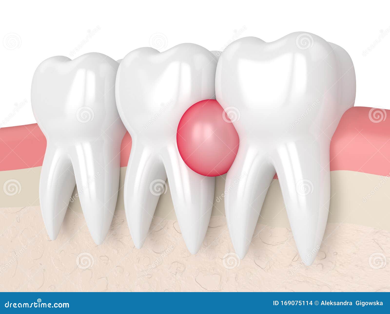 3d Render of Teeth in Gums with Cyst Stock Illustration - Illustration ...