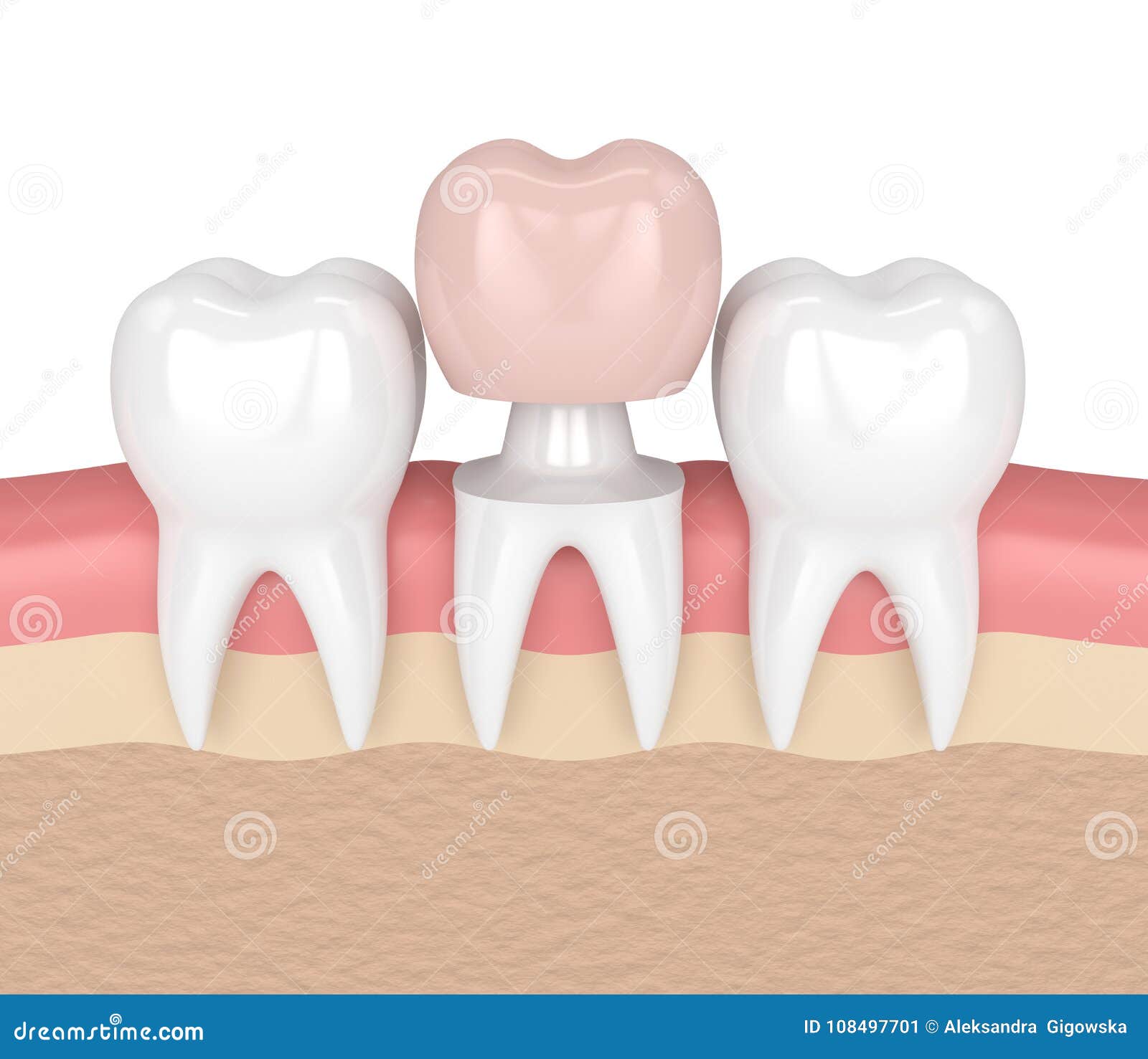 3d Render Of Teeth With Dental Crown Restoration Stock Image ...