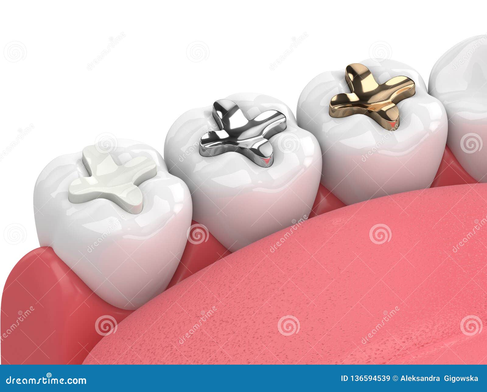 Inlay Ceramic Crown Fixation Over Tooth. Medically Accurate 3D ...
