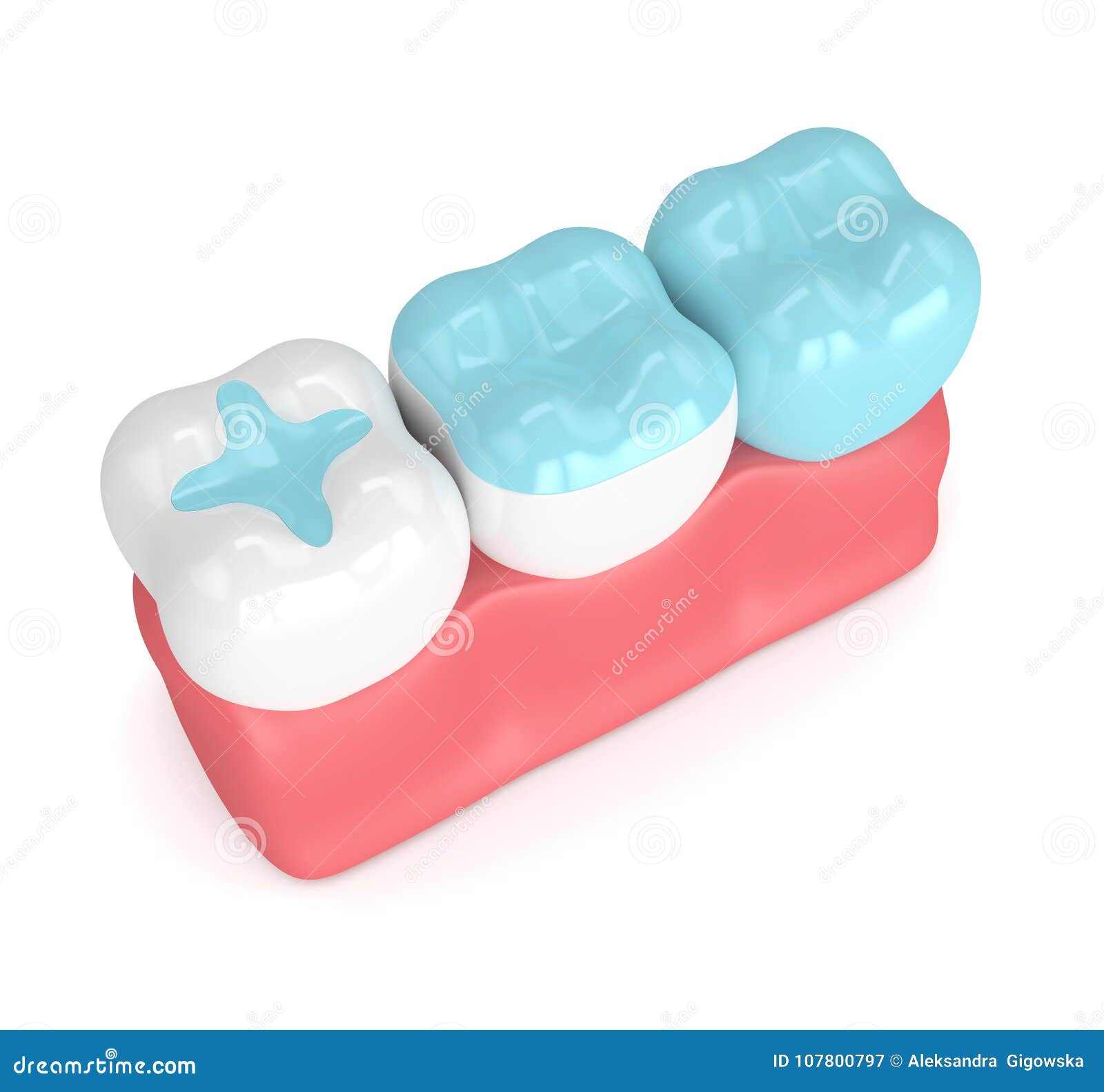 3d Render of Teeth with Different Types of Filling Stock Illustration ...
