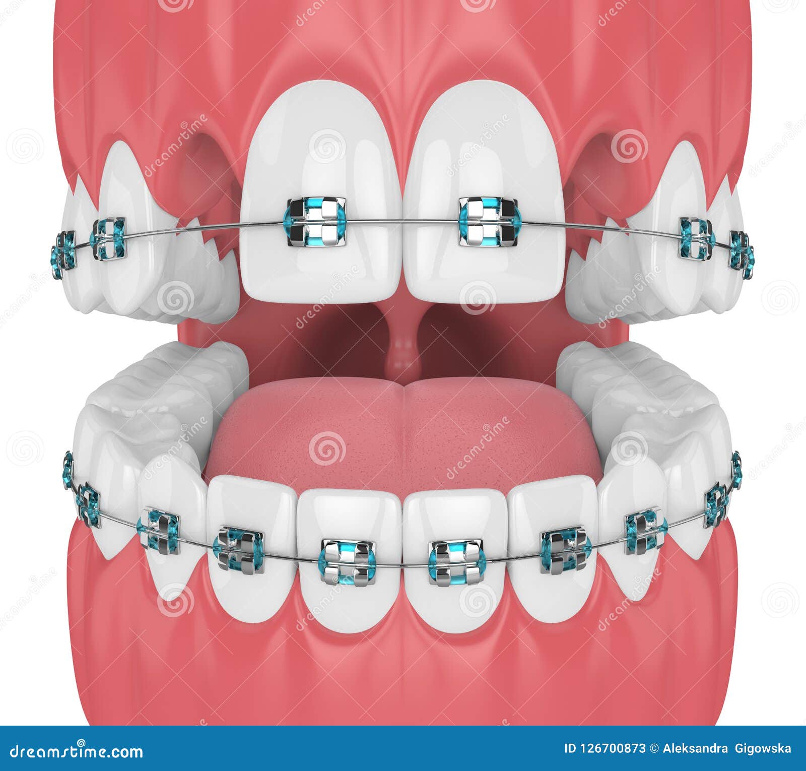 Orthodontic Braces Banner With Teeth Characters Cartoon Vector ...