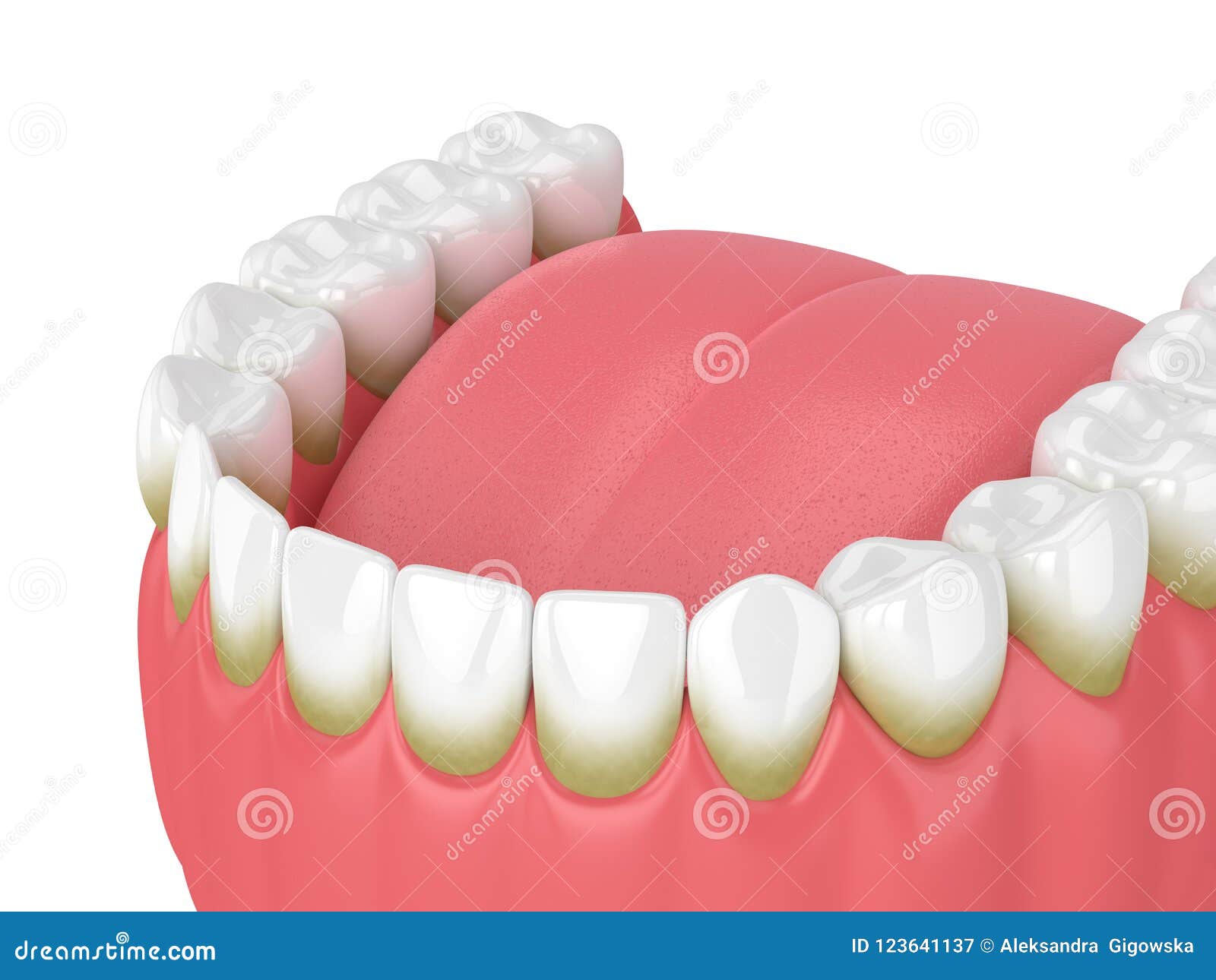 Tartar Or Calculus Teeth Illustration Vector On Blue Background ...